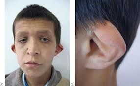 Branchio-oto-renal (BOR) syndrome | Scrolller