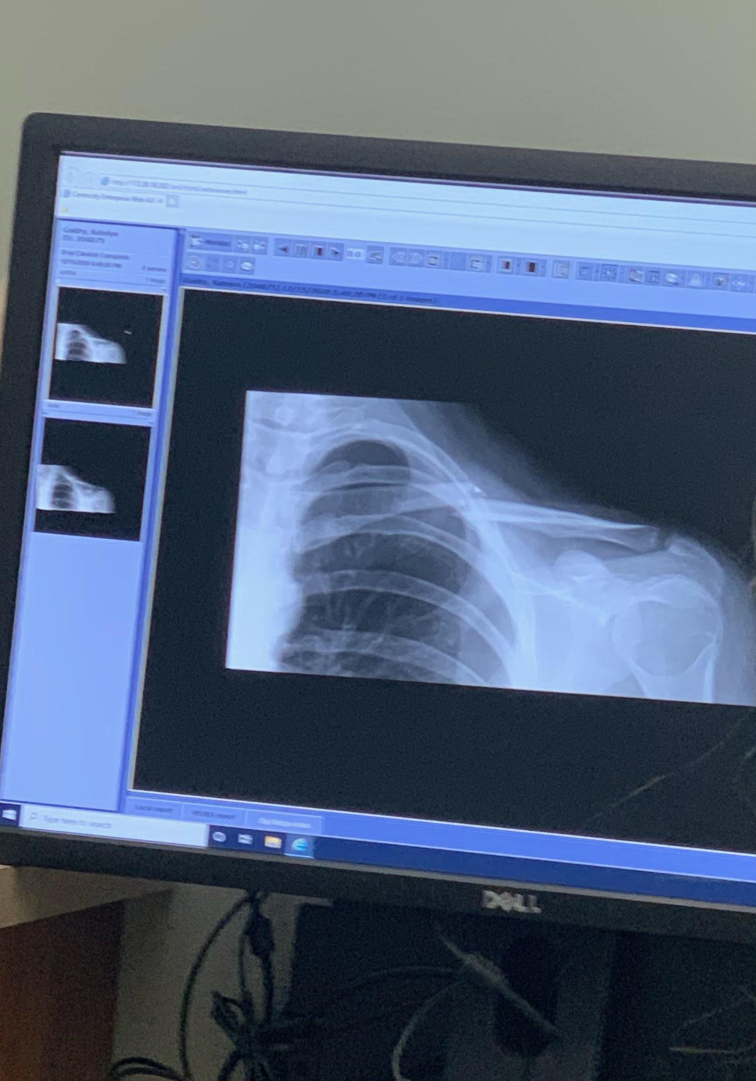 Broken Collarbone-skiing accident | Scrolller