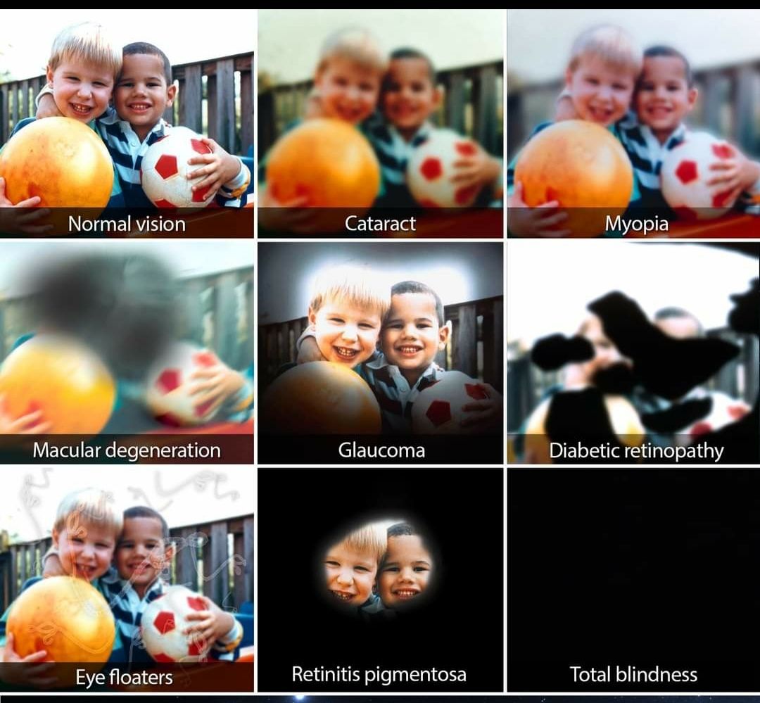 Categories of visual impairments. | Scrolller