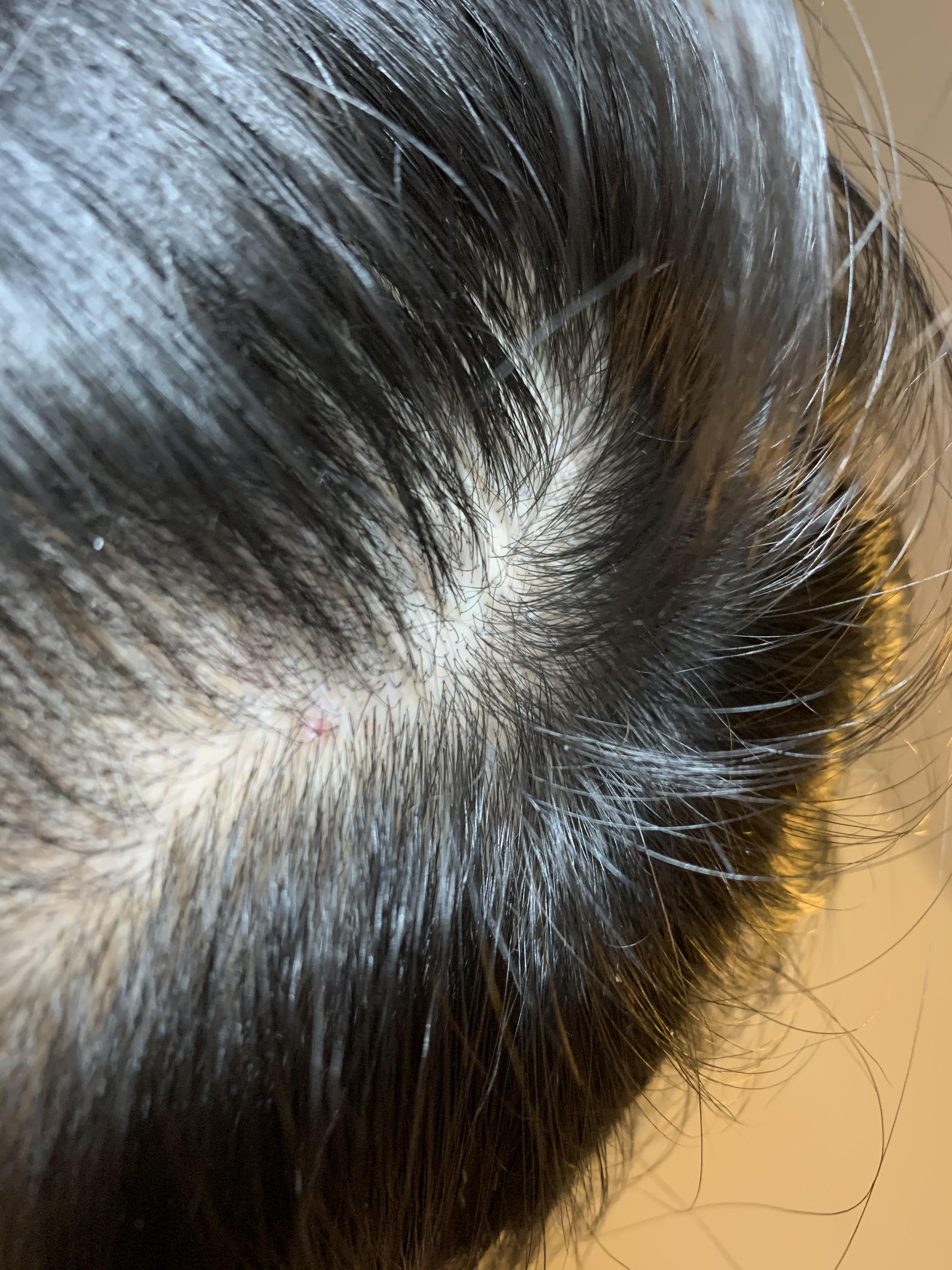 Do you think this is folliculitis? | Scrolller