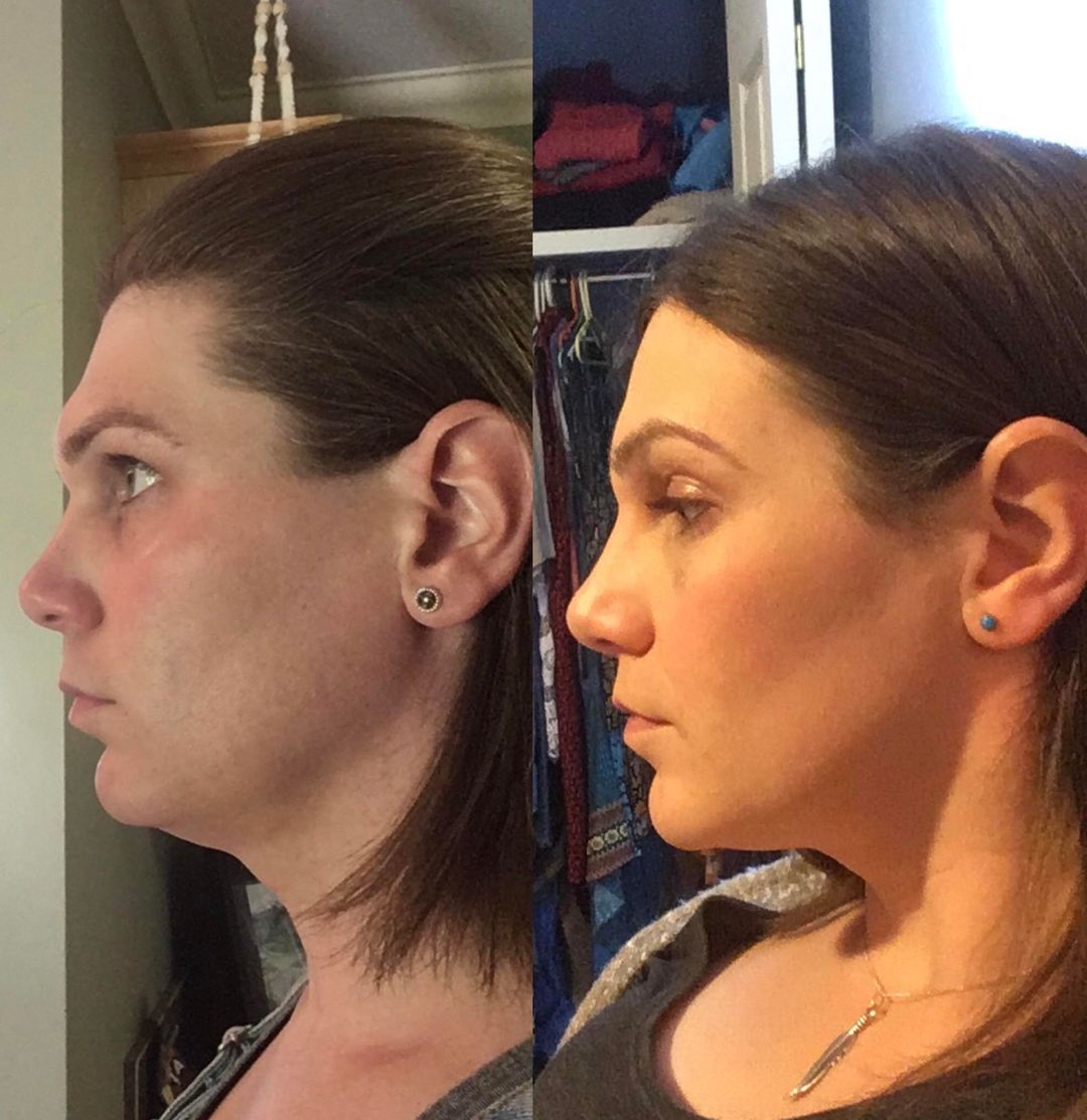 FFS 2.5 month post-op side profile. Dr.Cardenas | Scrolller