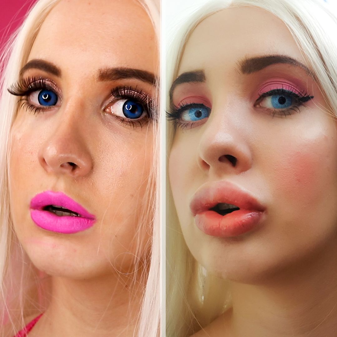 Finally, bimbo lips. Went for 2 syringes at a time 💖 | Scrolller