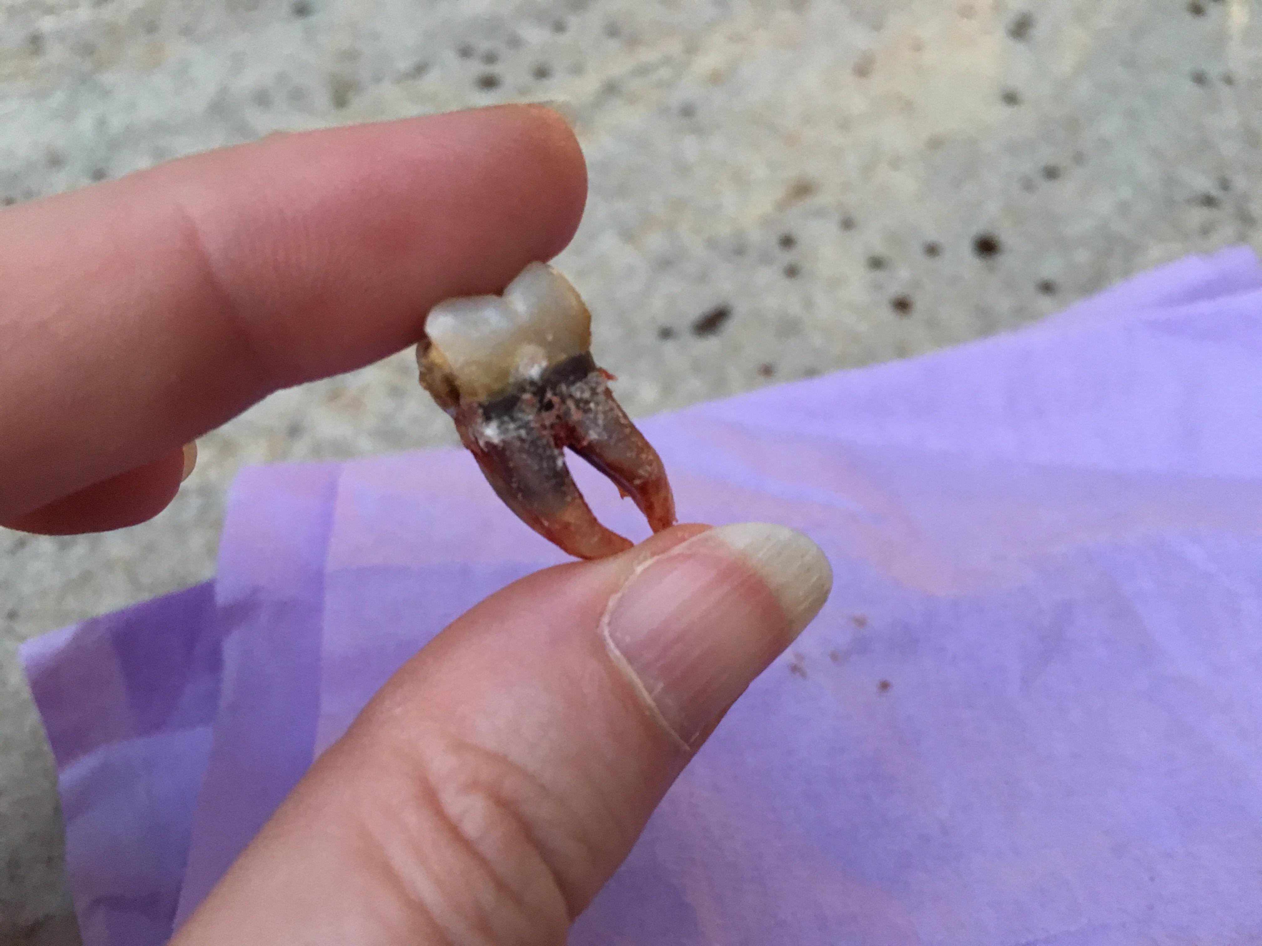 Finally got this tooth removed 6 years after initial infection. | Scrolller