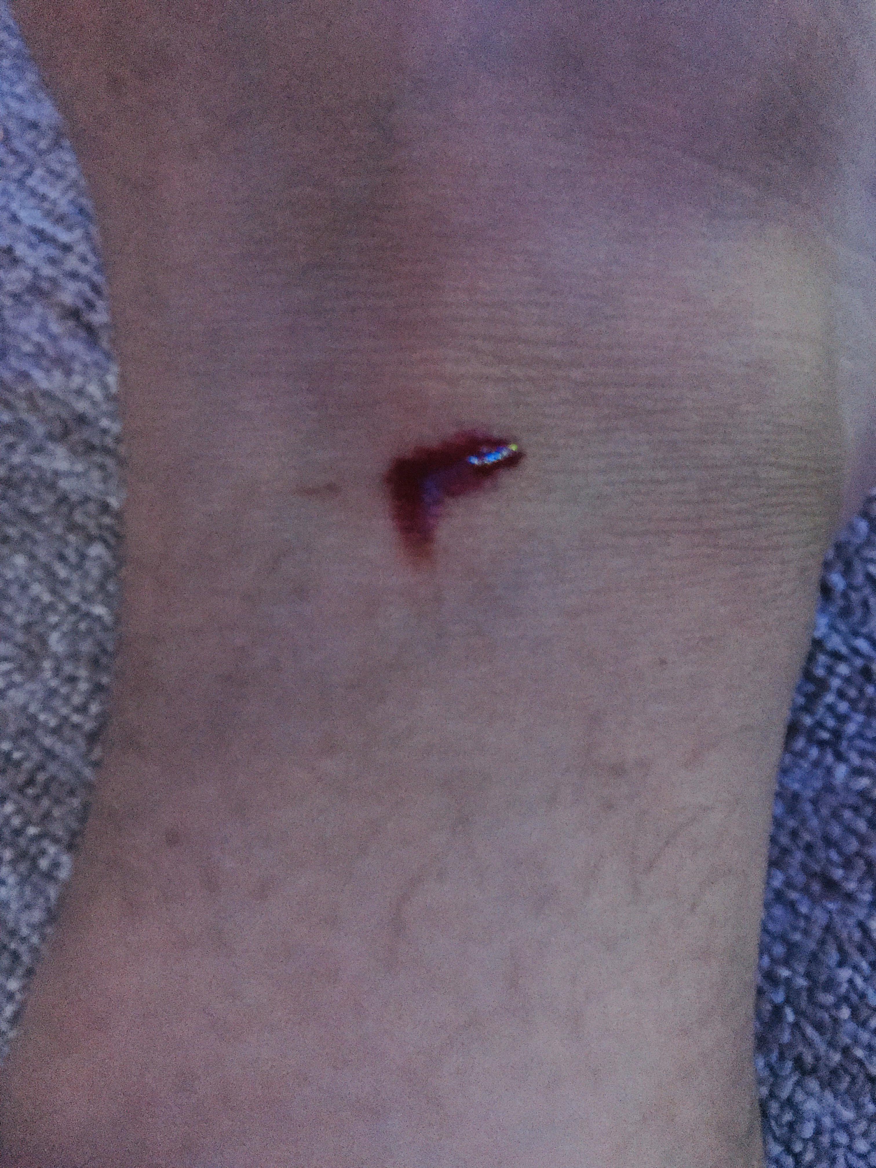 Got this scar on my leg from stepping on glass | Scrolller