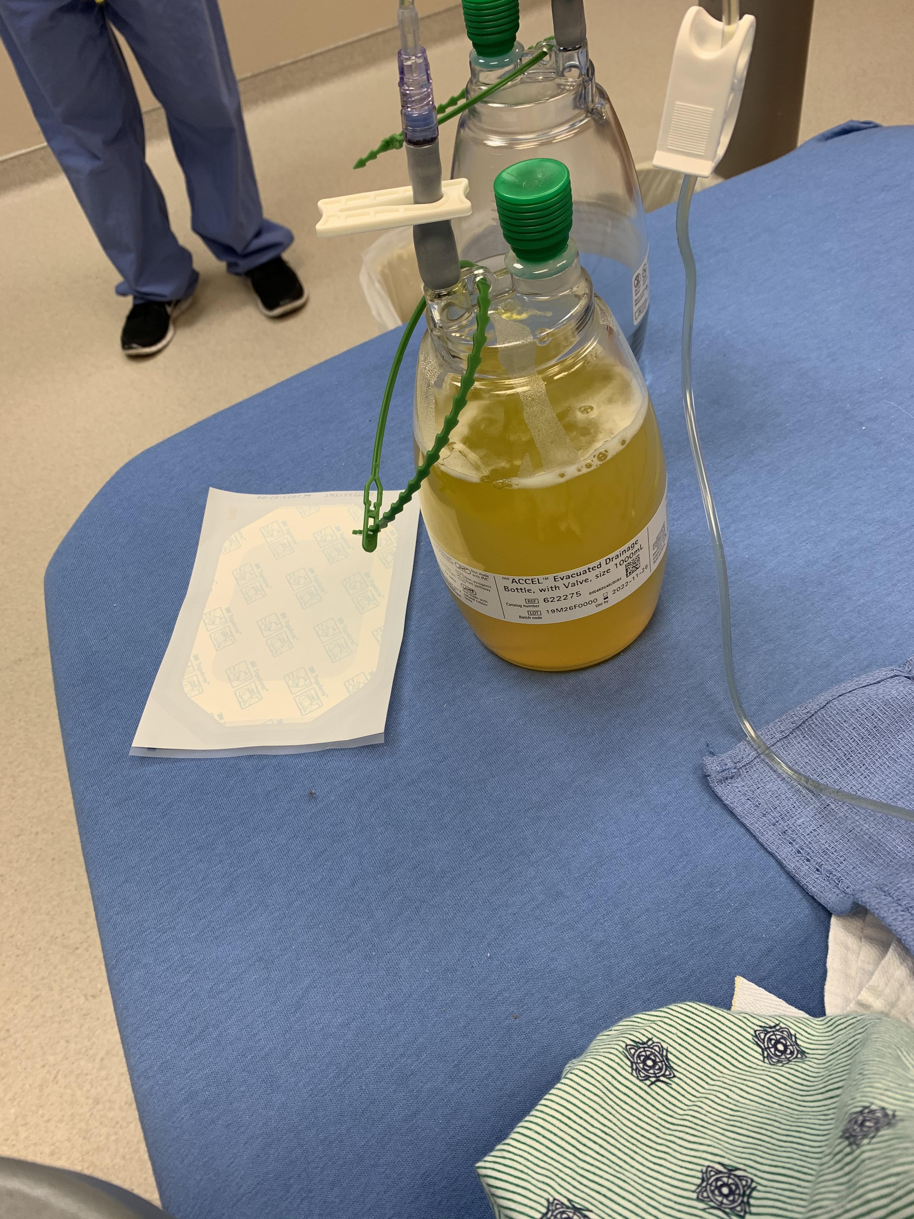 Had trouble breathing. 1 litter removed from around my lungs. | Scrolller