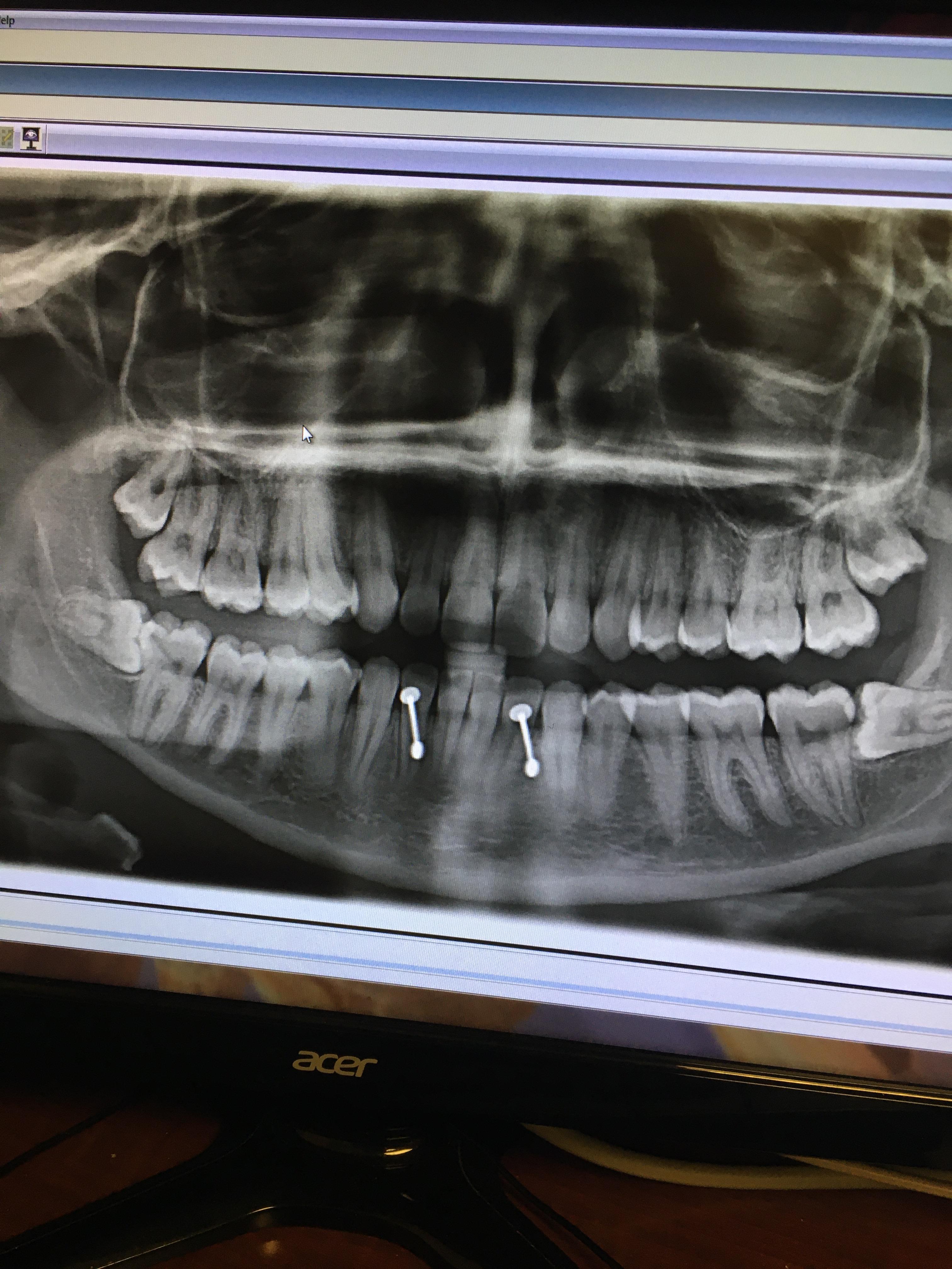 Hehe my wisdom teeth | Scrolller
