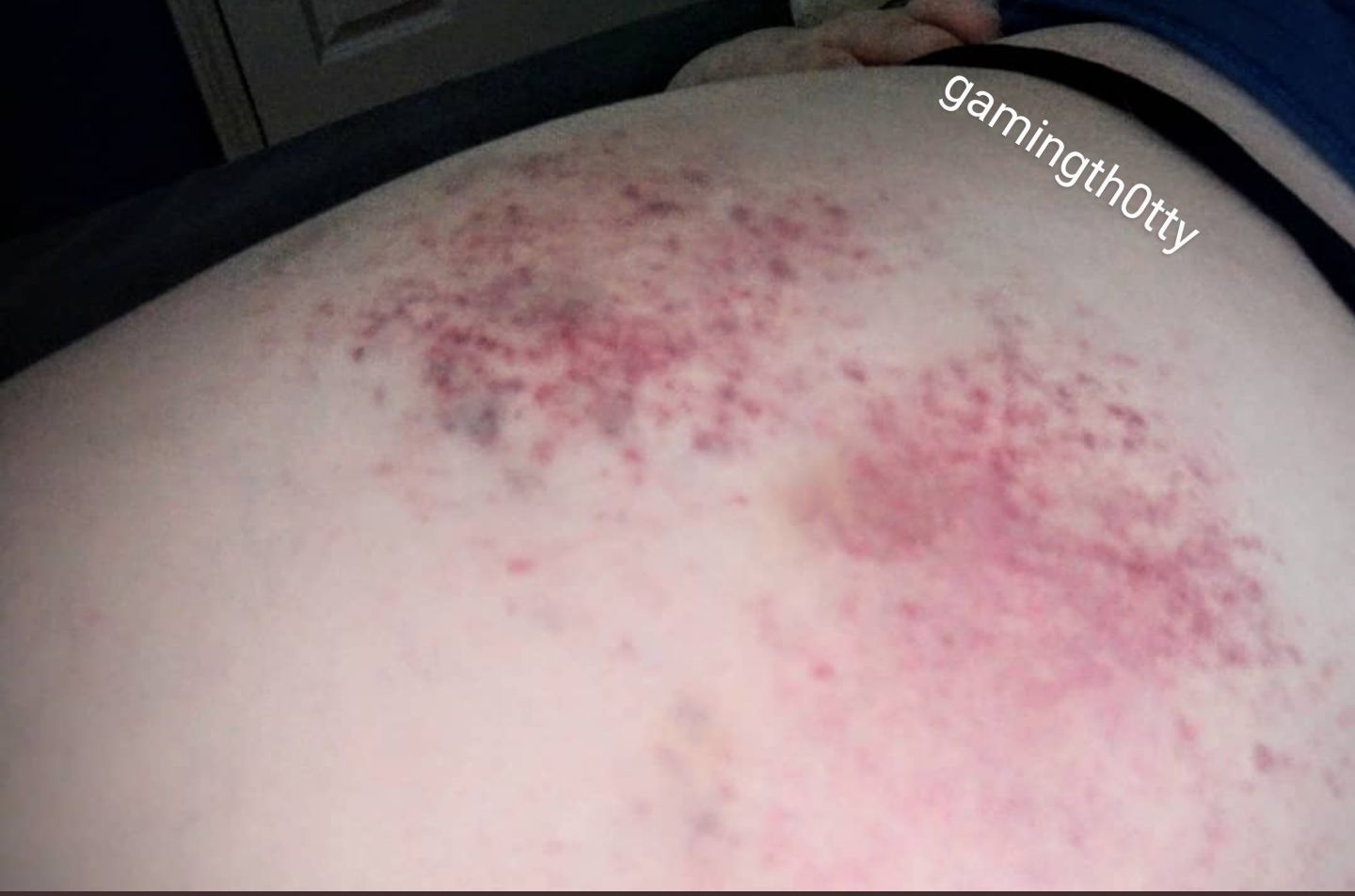 [OC] Does anyone here like bruised butts??😊 | Scrolller