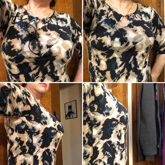 I wanted to share my before/after, two weeks post op | Scrolller