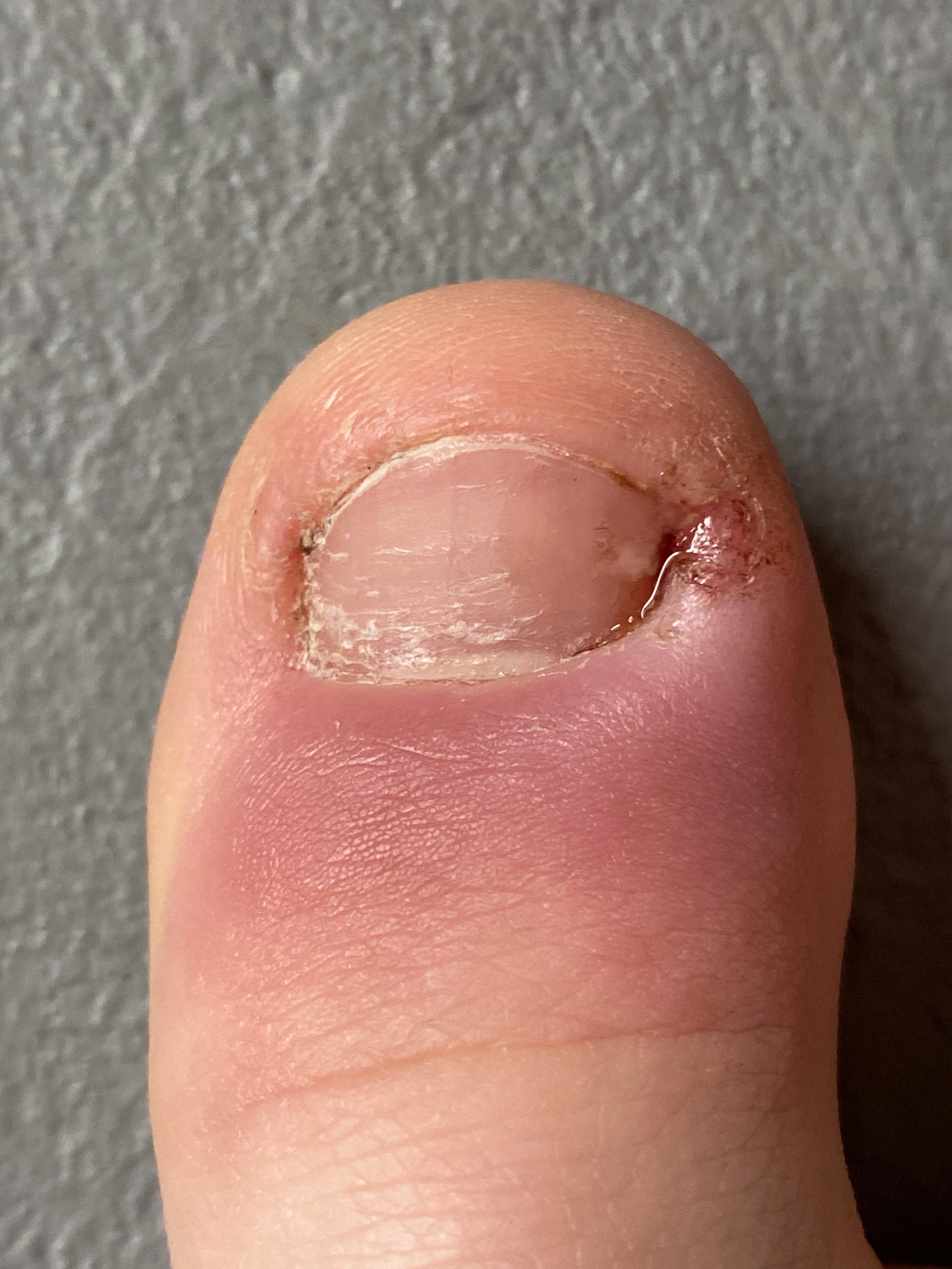Infected Toe (sorry) | Scrolller