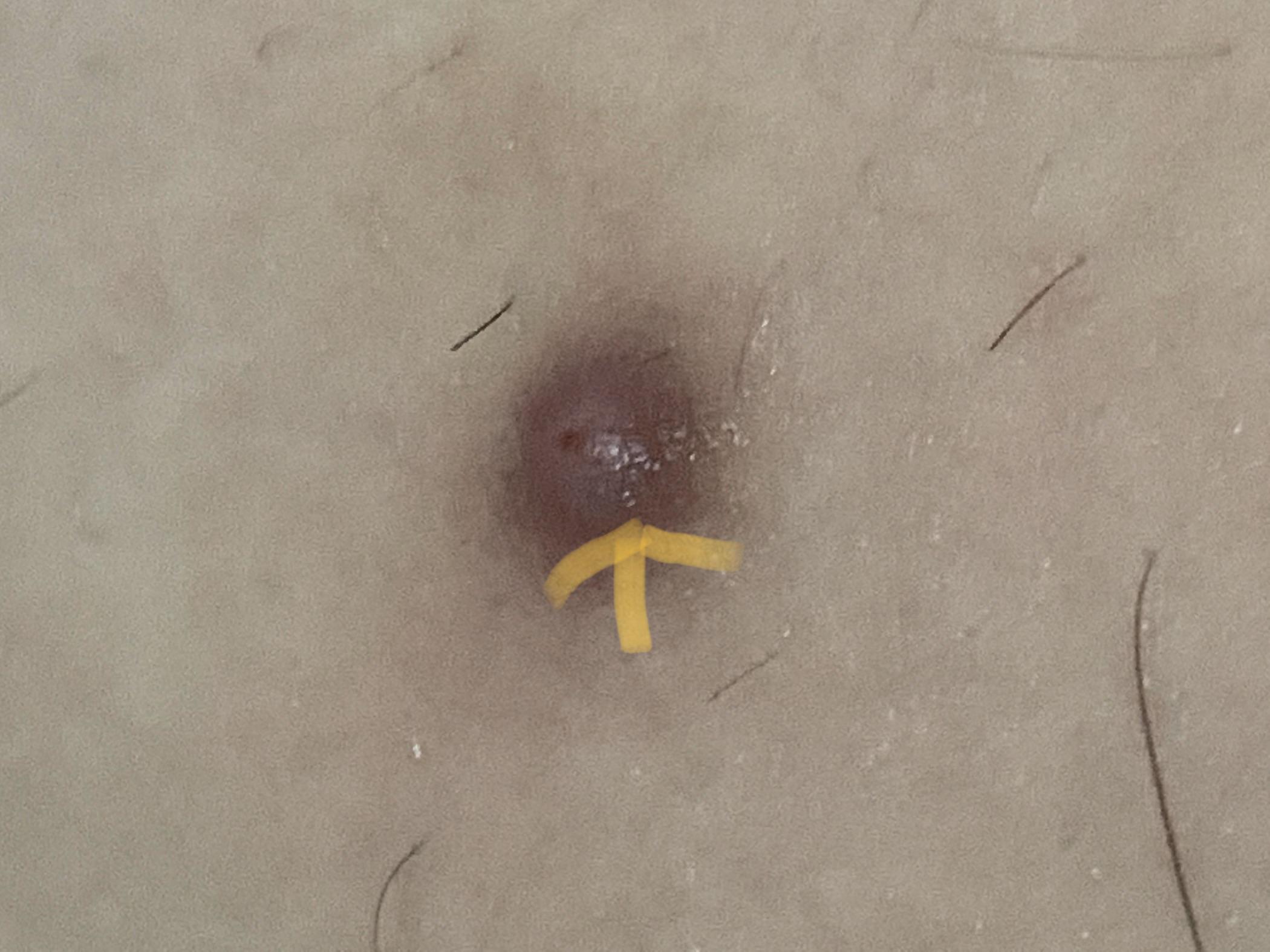 Ingrown hair or folliculitis or herpes? | Scrolller