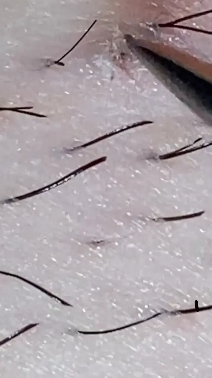 Ingrown Hair Removal Scrolller