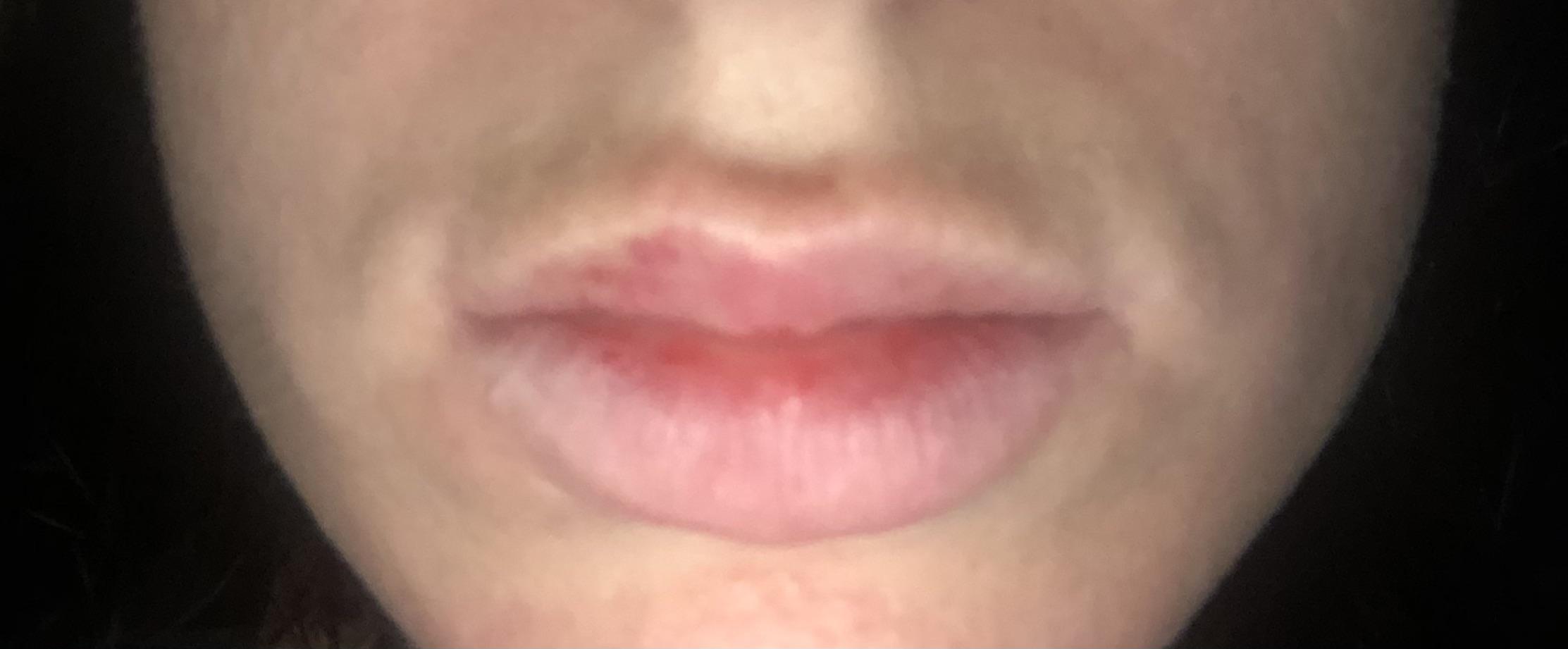 Is it normal to have the swollen mustache/duck lip after 2-3days of 1ml Juvaderm? | Scrolller