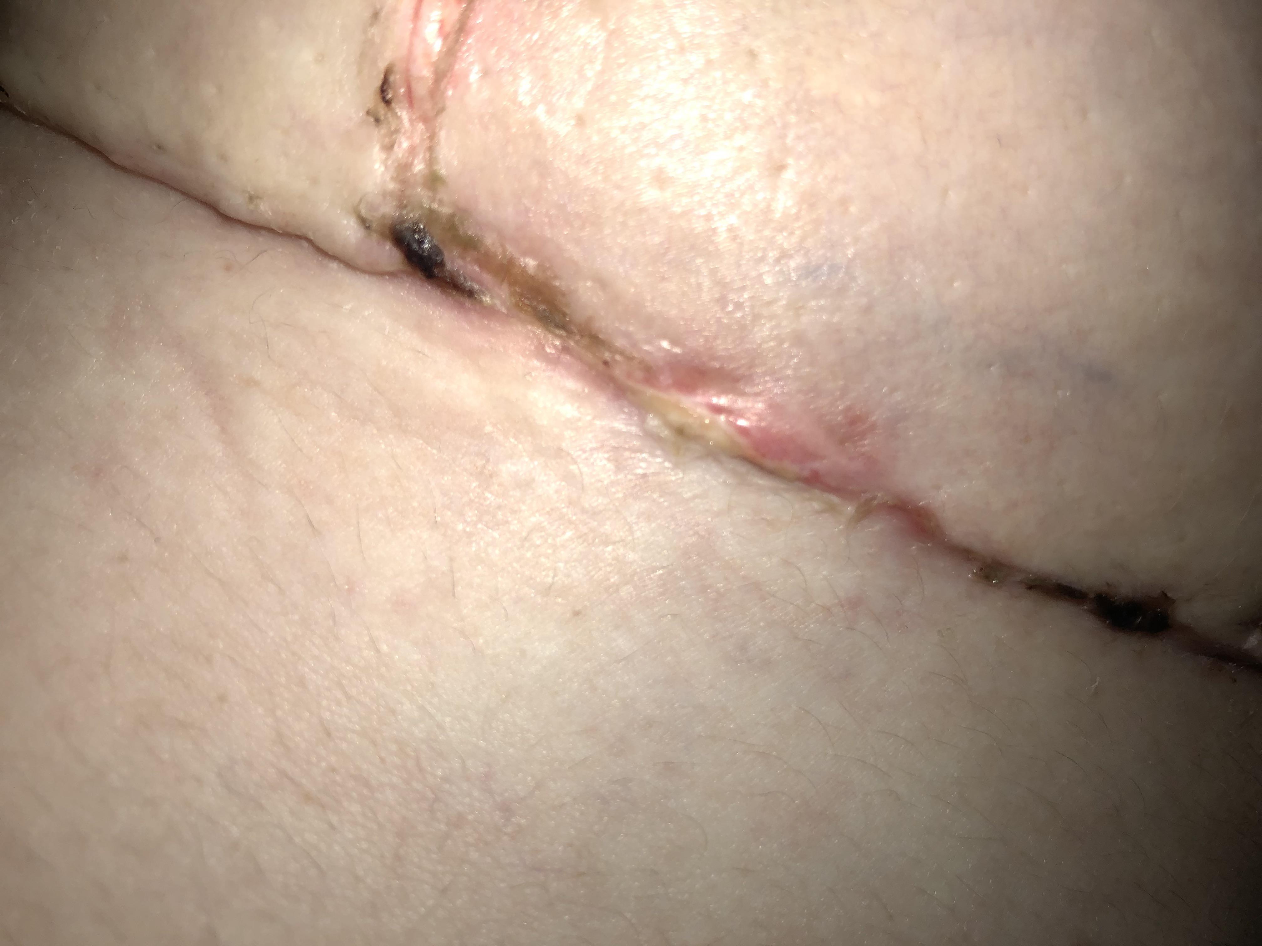 Is my bottom incision infected? 23 days post op | Scrolller