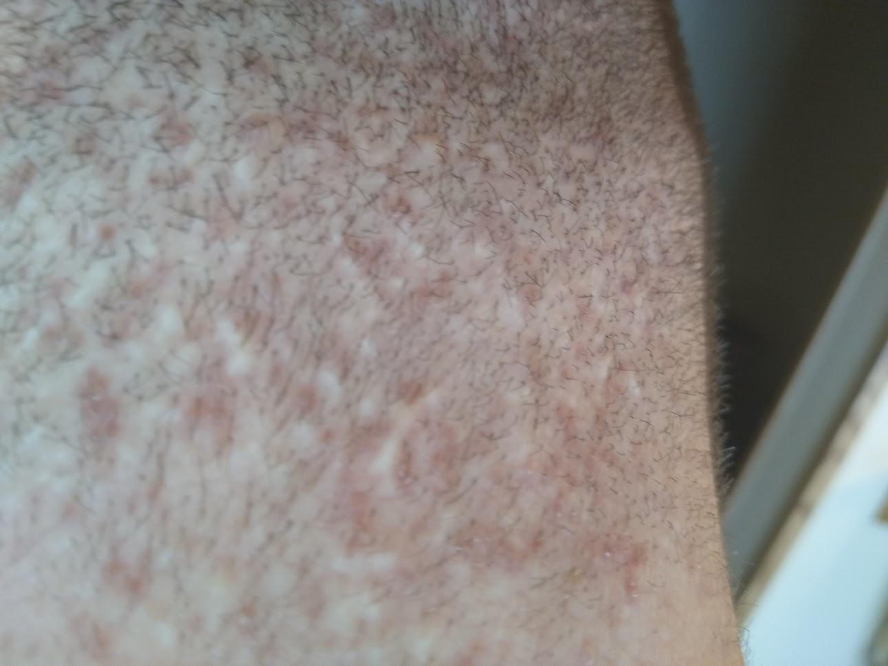 Is the redness folliculitis or just scarring from my folliculitis? | Scrolller