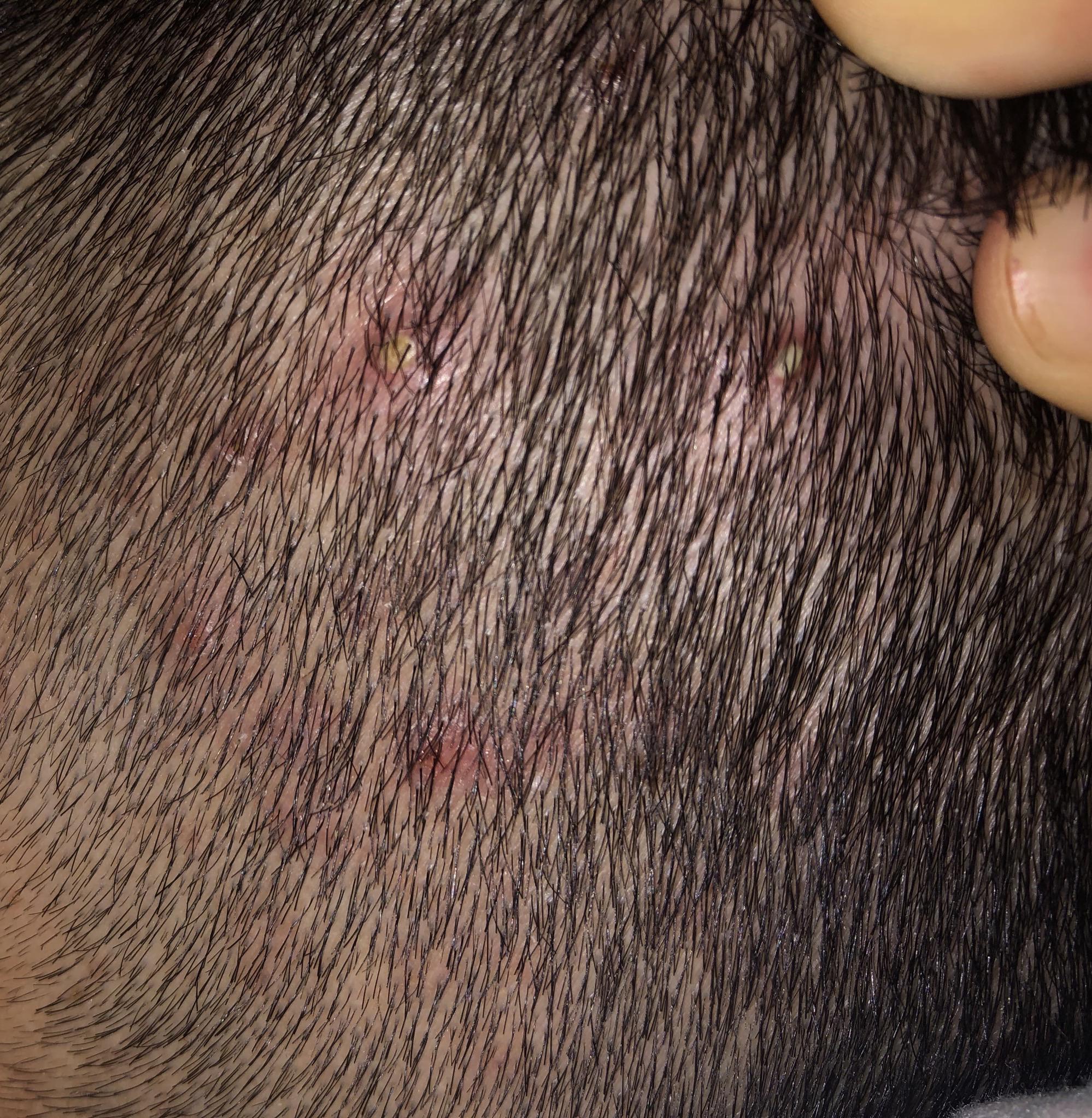 Is this folliculitis and best way to treat? | Scrolller