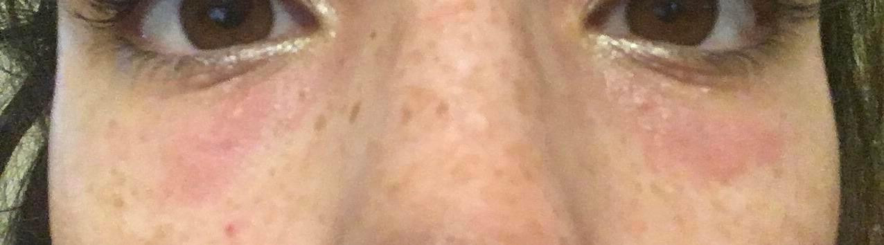 Itchy puffy redness below eyes that comes and goes. | Scrolller