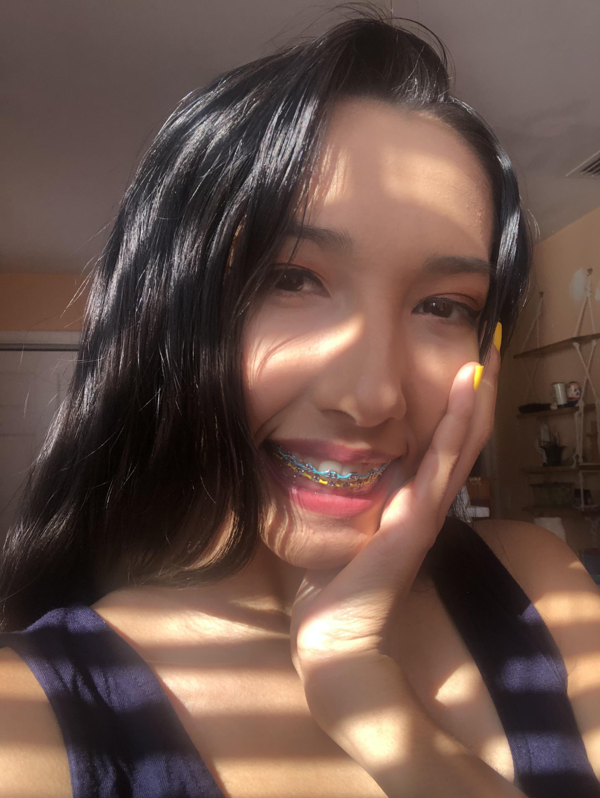 Last color for my braces 💛💙 | Scrolller