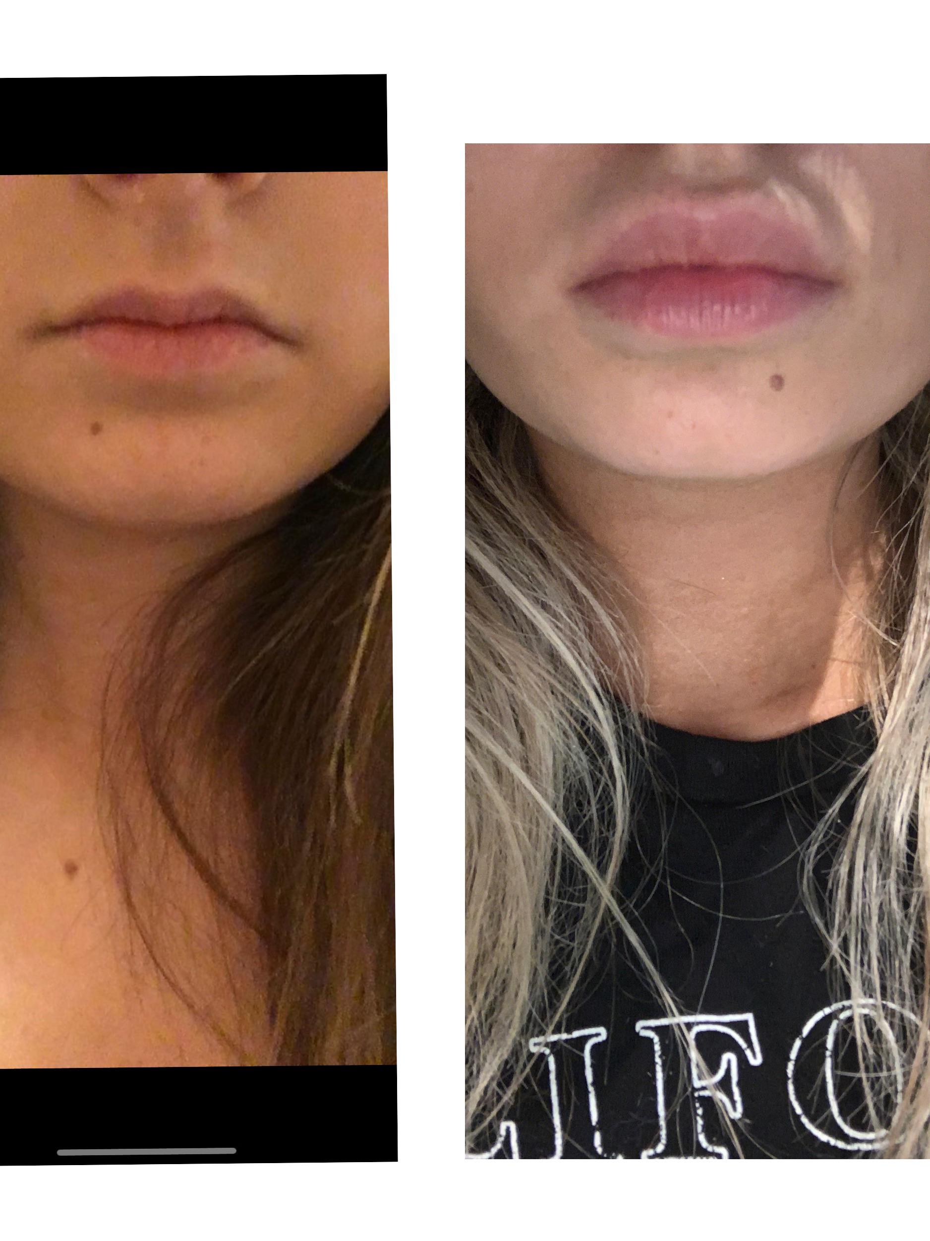Lip progress over years | Scrolller