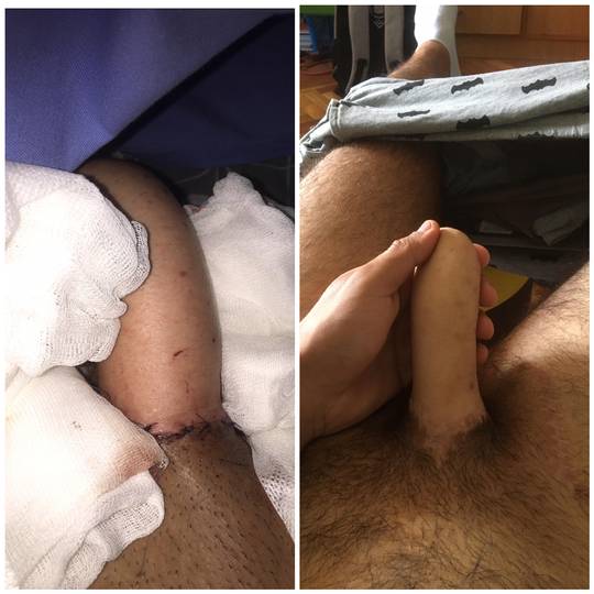 MLD phallo 1 day vs 7 months post op | Scrolller