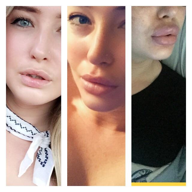 My lip transformation | Scrolller