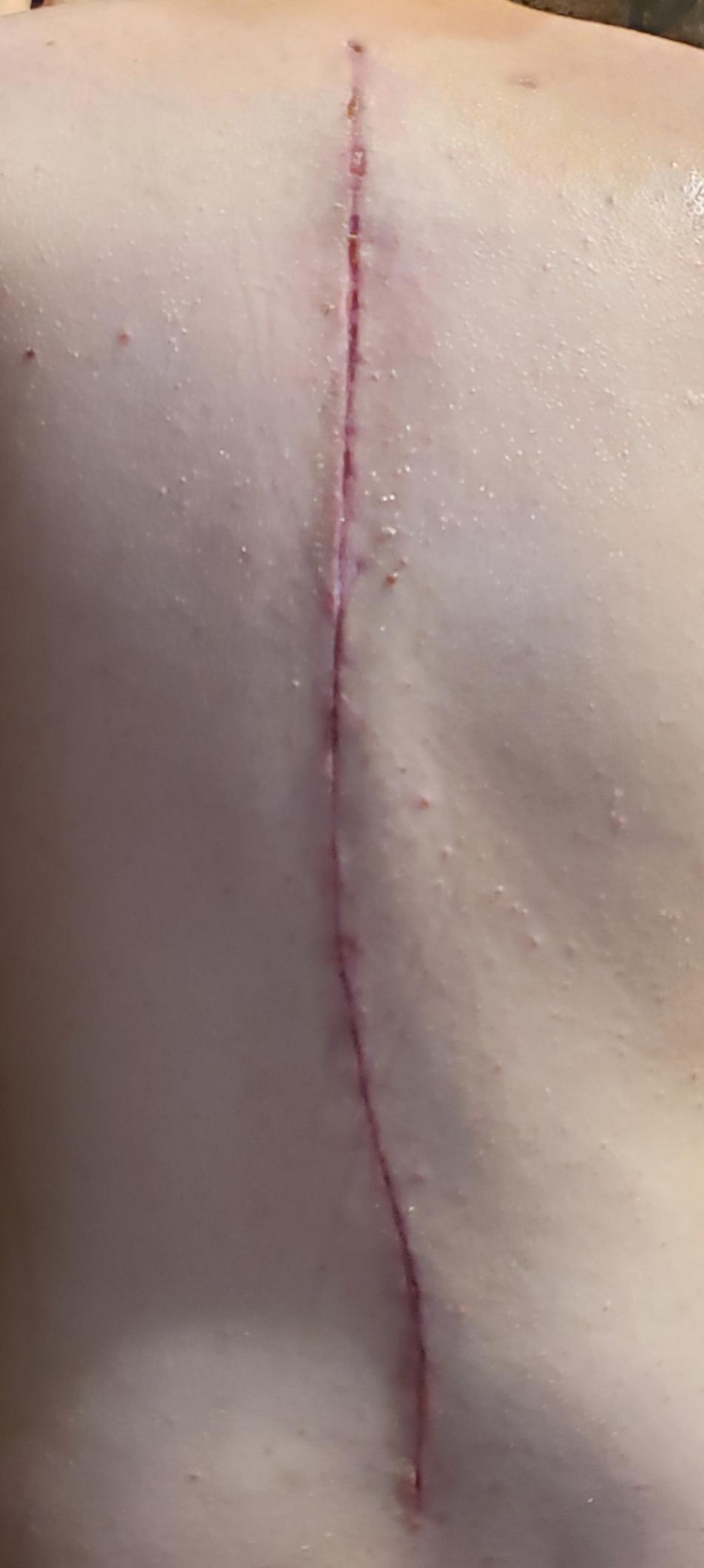 my scoliosis scar | Scrolller
