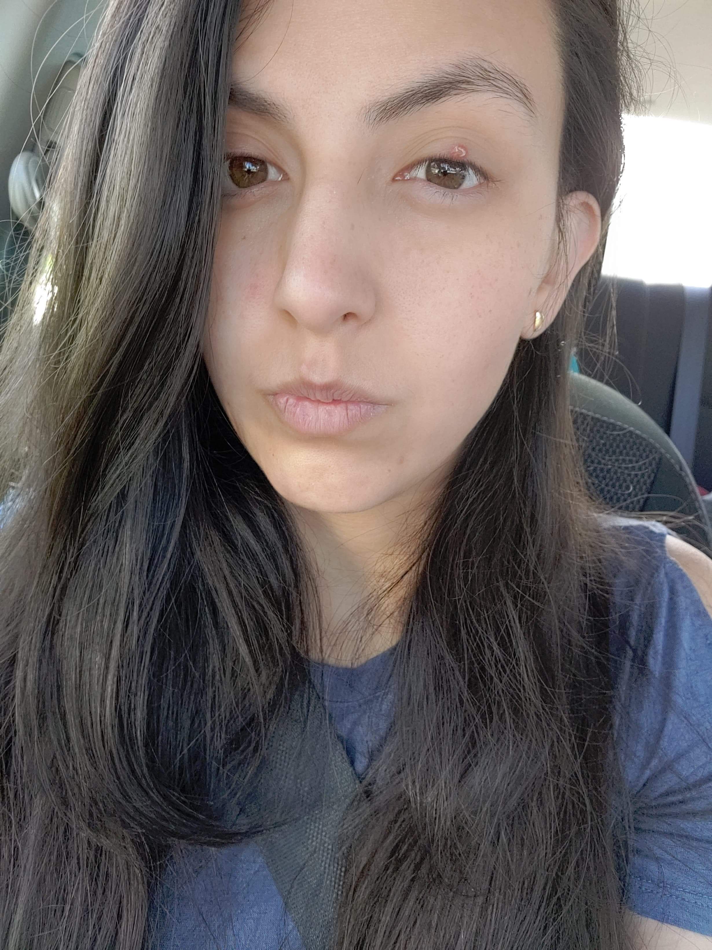 My stye is finally going down | Scrolller