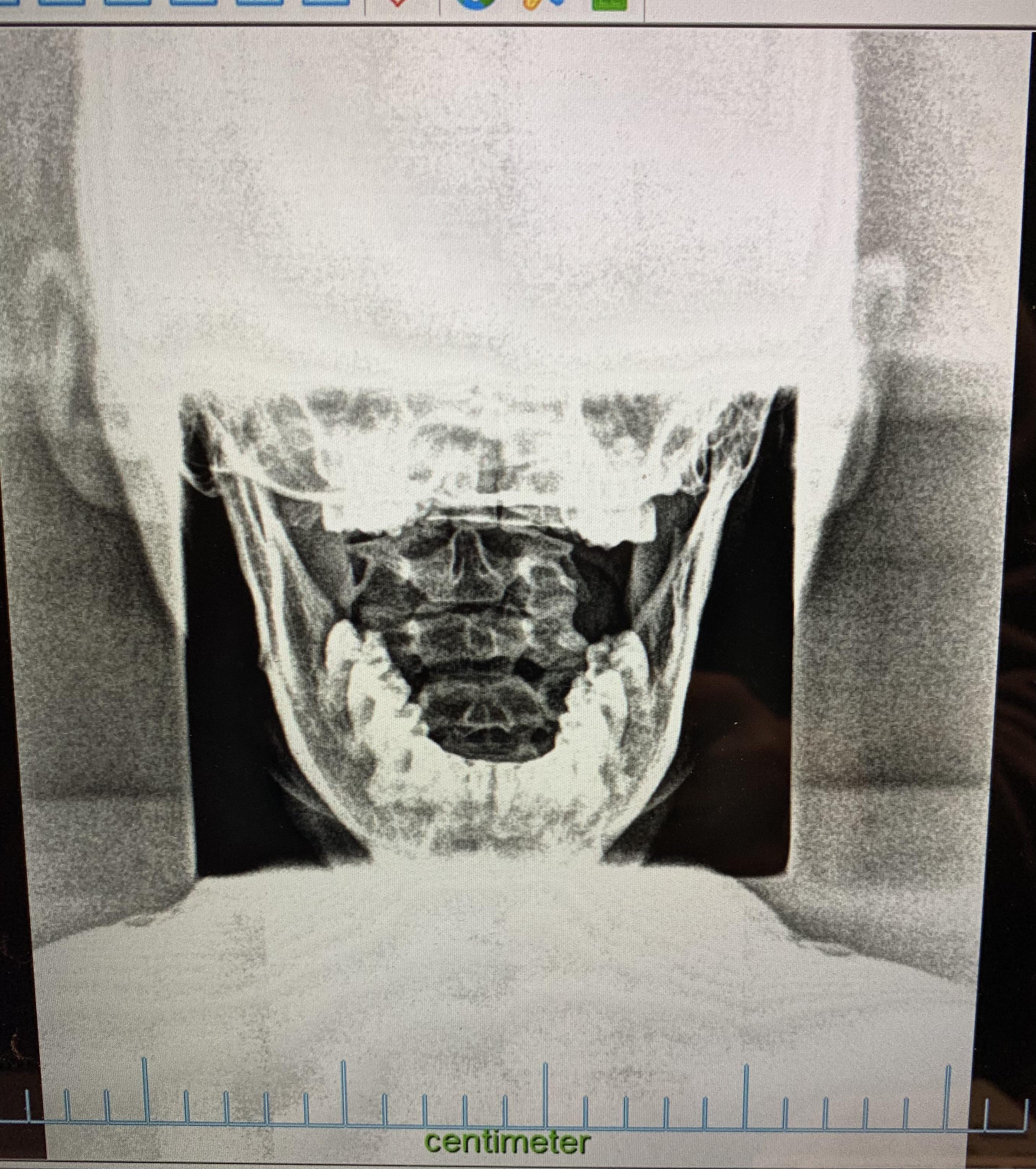 Neck x ray | Scrolller