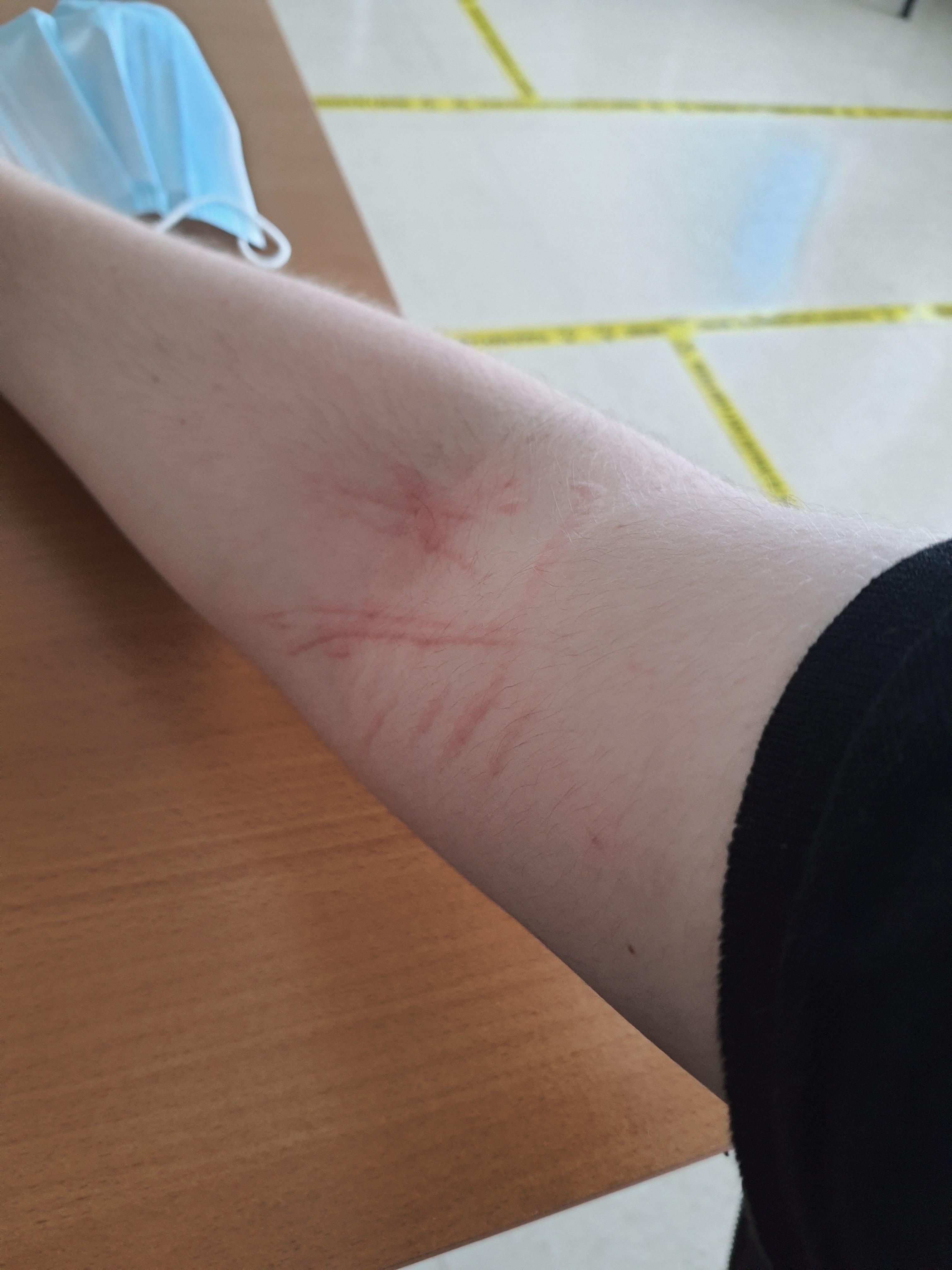 "OMG WTF HAPPENED TO YOUR ARM" | Scrolller