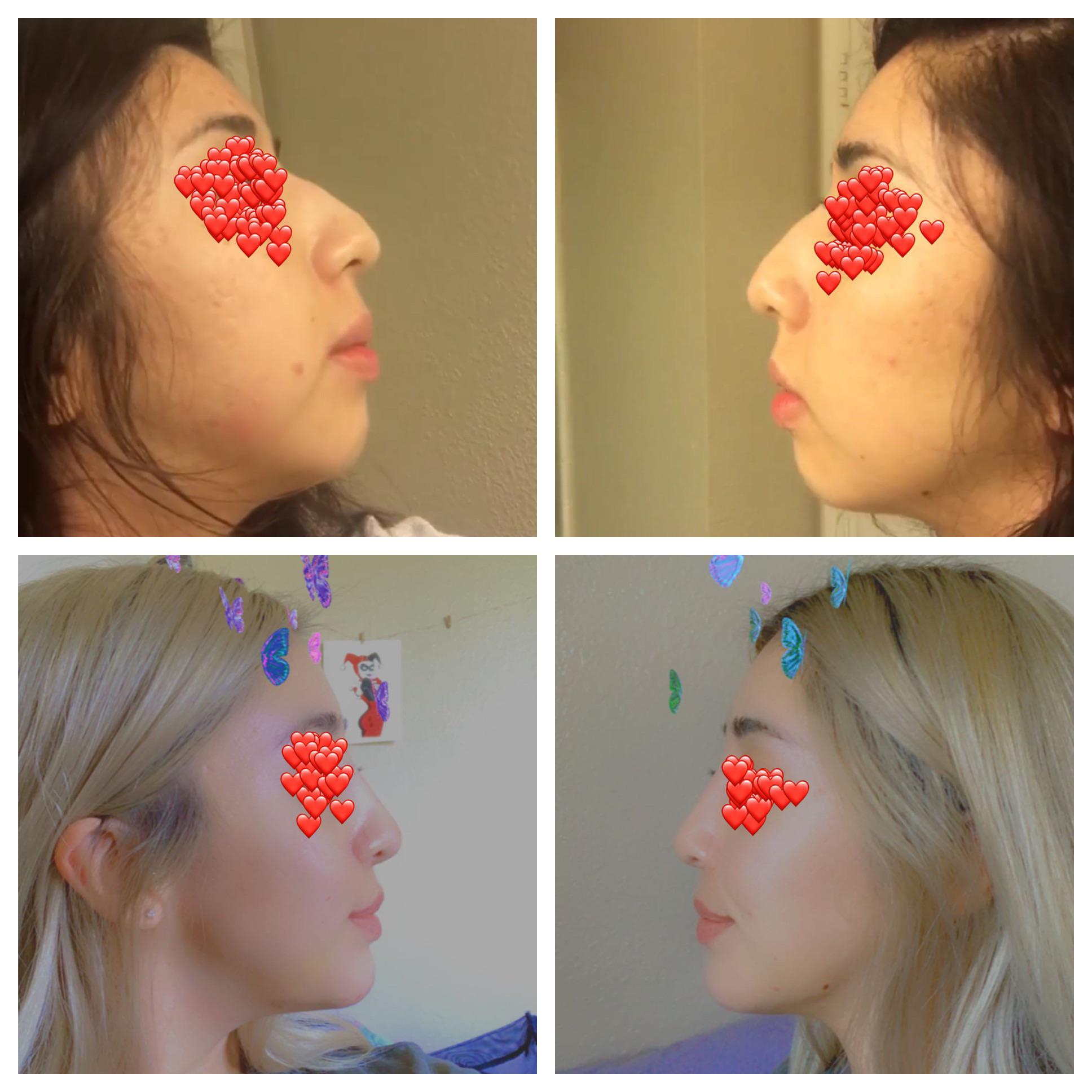 Post Orthodontics, Rhinoplasty, & Chin Implant (3 Year Challenge) | Scrolller