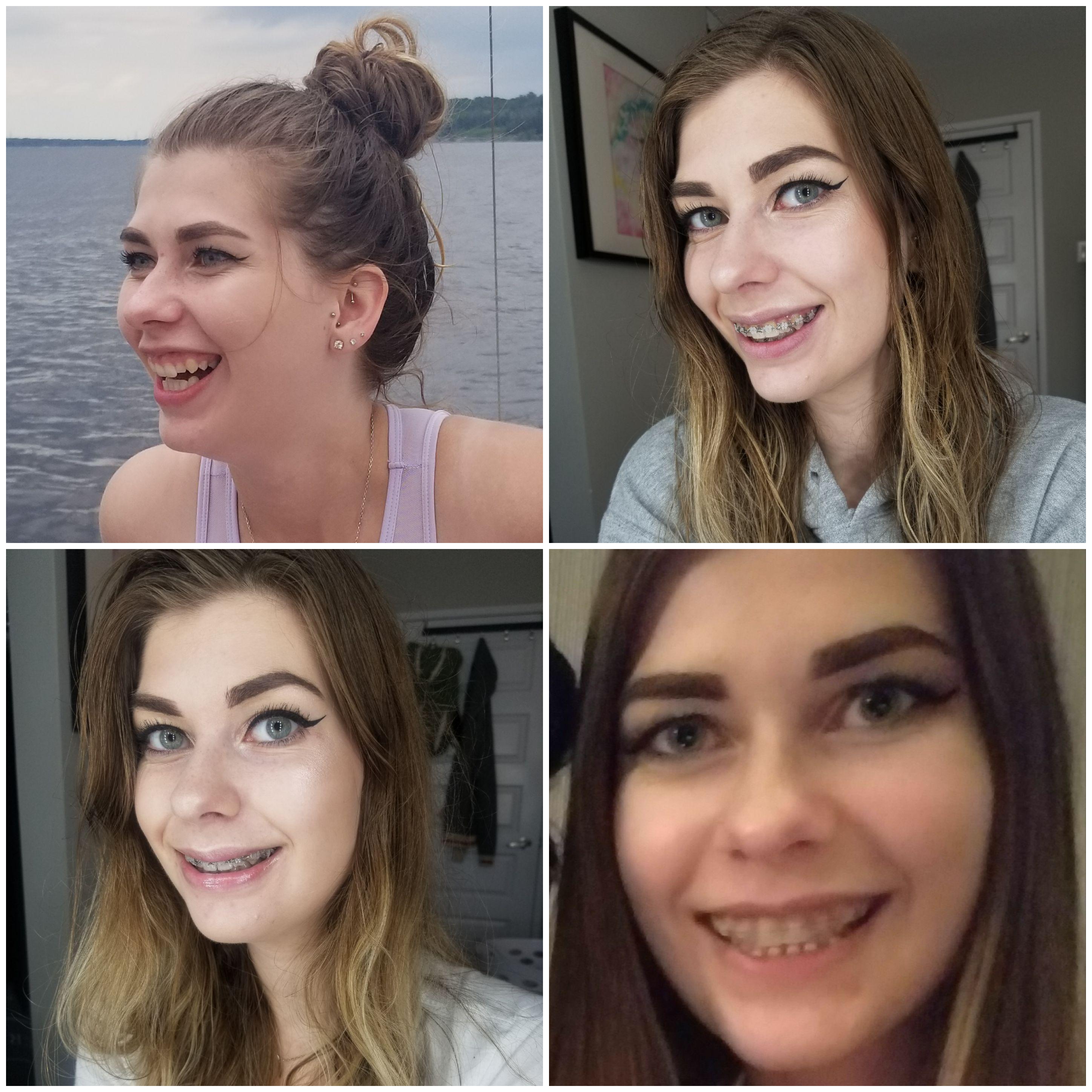 Pre-braces vs. Pre-OP vs. 2.5 weeks post-OP vs. 7 weeks post-OP. DJS for overbite, 3 piece ...