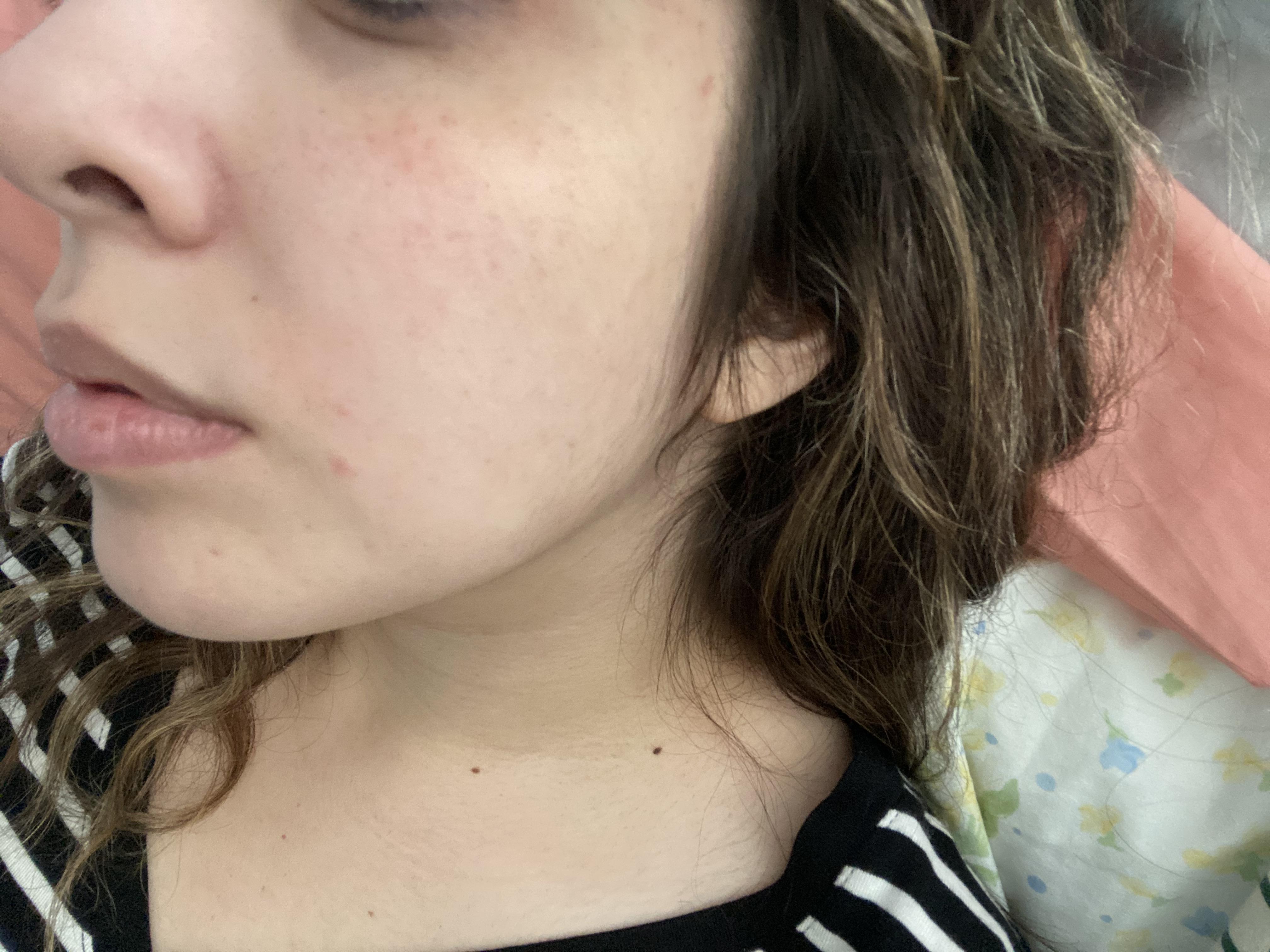 Throwback to face bruises. | Scrolller