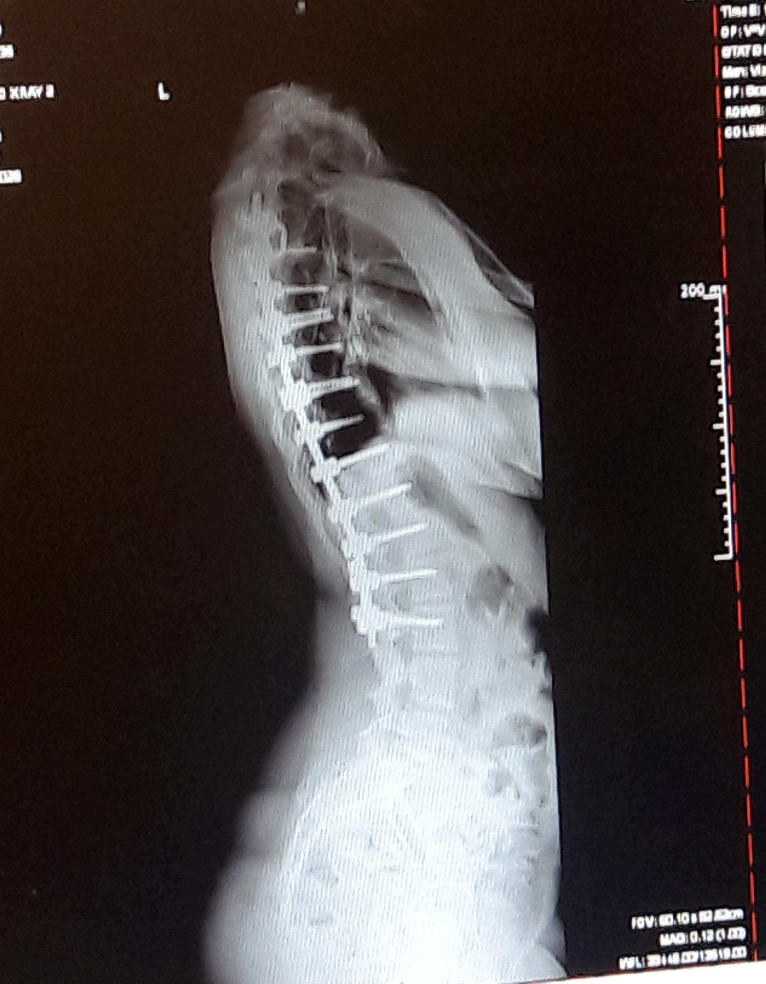 Side View of a Full Spinal Fusion | Scrolller