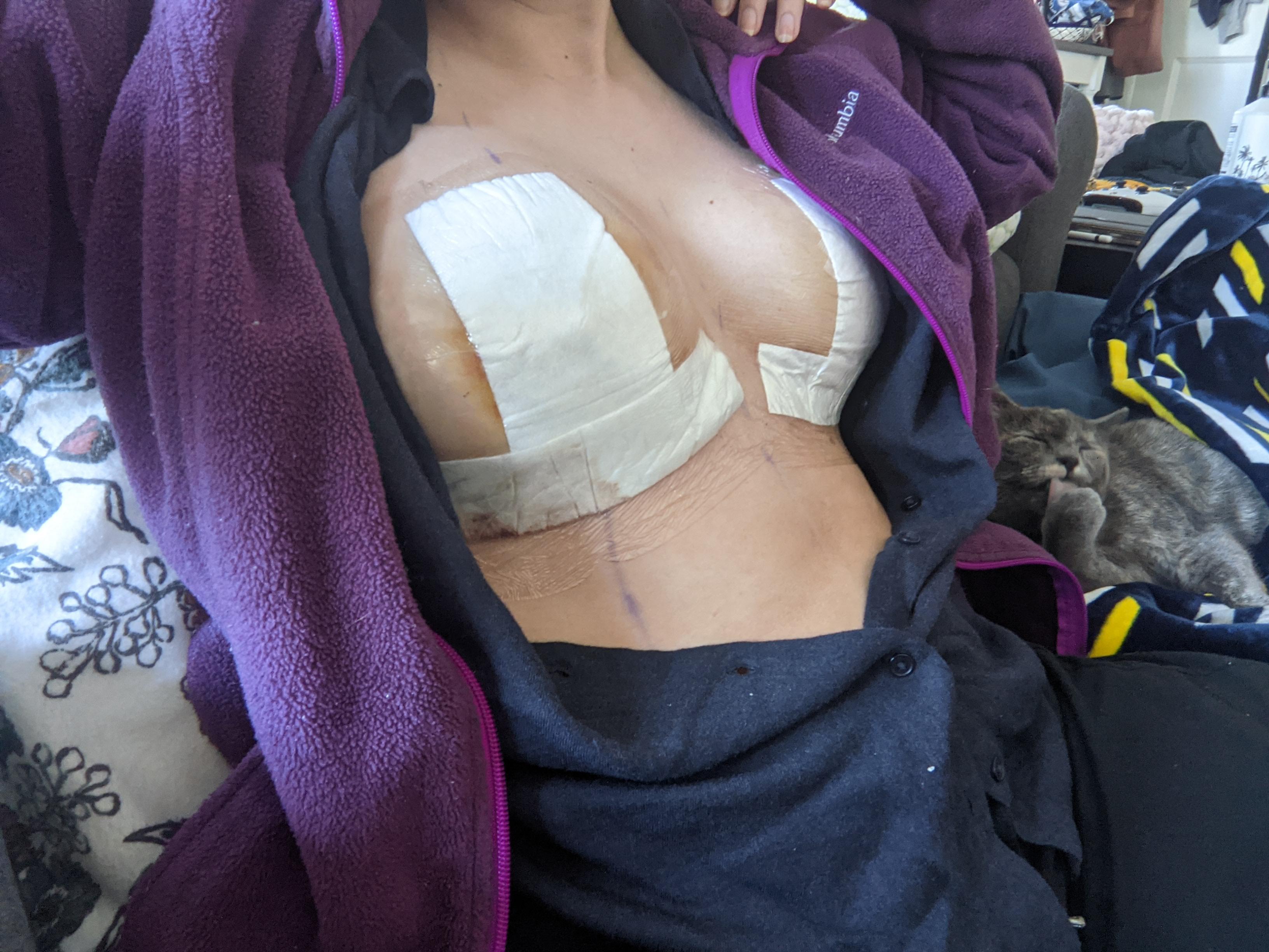 Surgery was on Nov. 23rd! Pre op pics in post history. | Scrolller