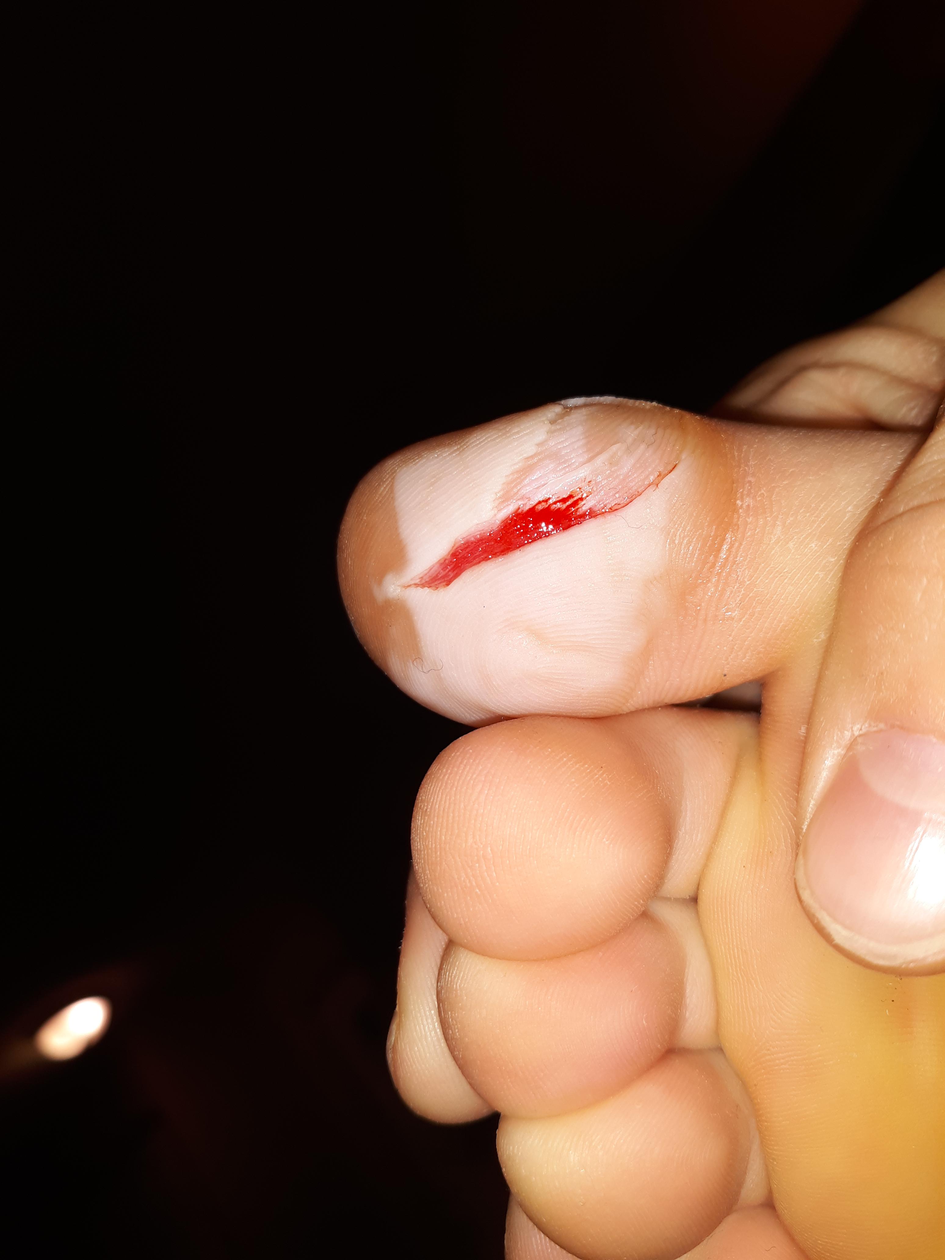 The bottom of my big toe | Scrolller