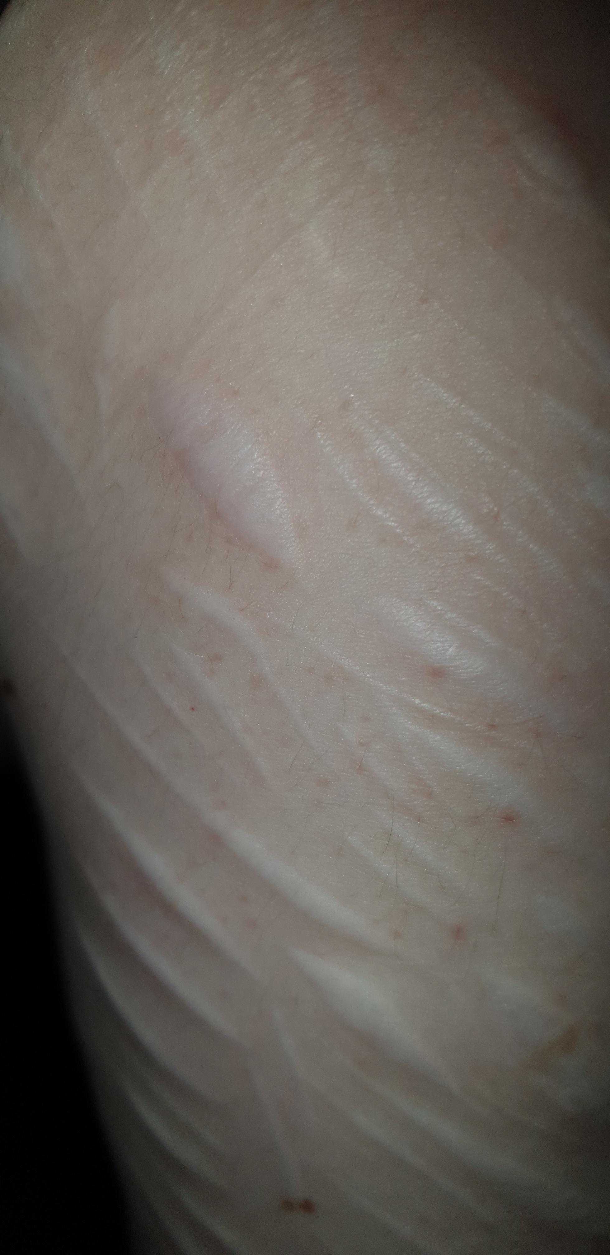 TW: Scars from 5 years ago | Scrolller