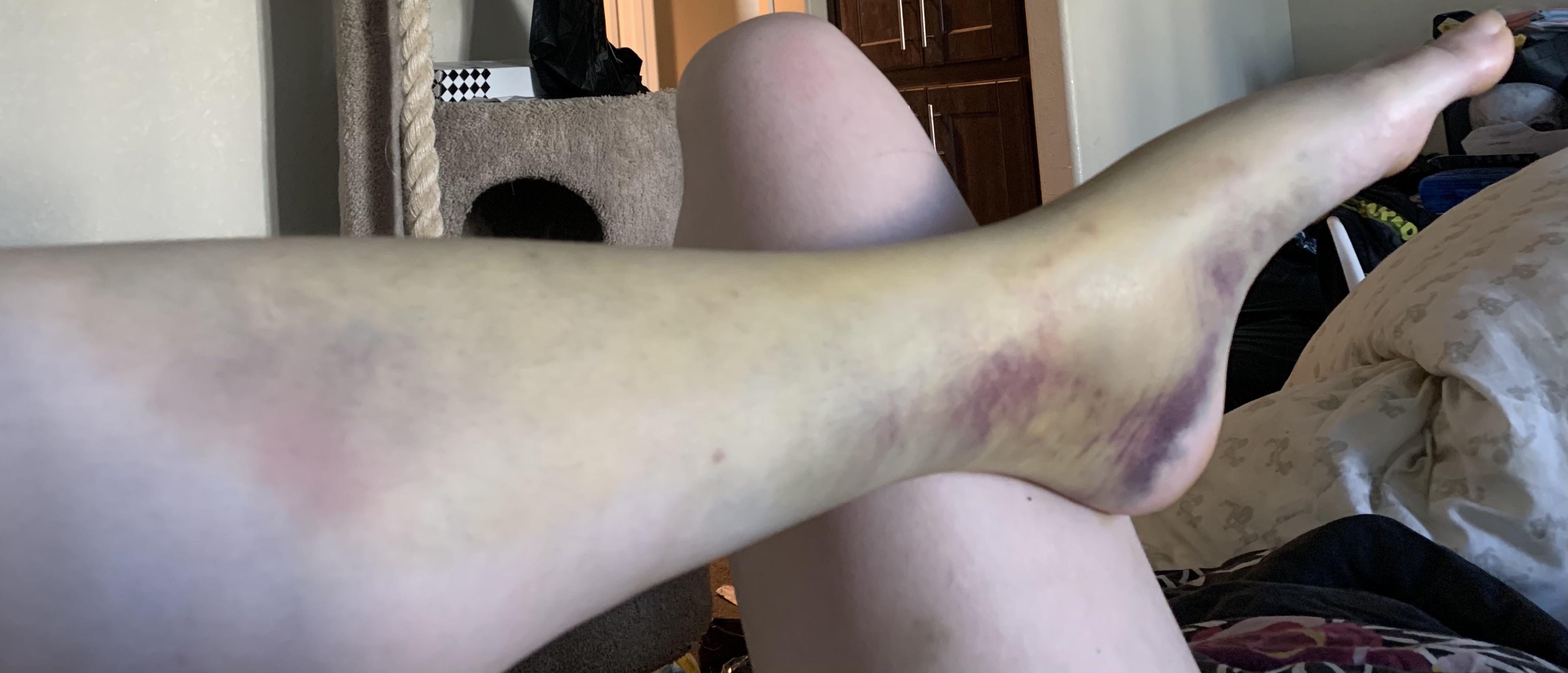 Twisted My Ankle And Bruise Makes Me Look Dead | Scrolller