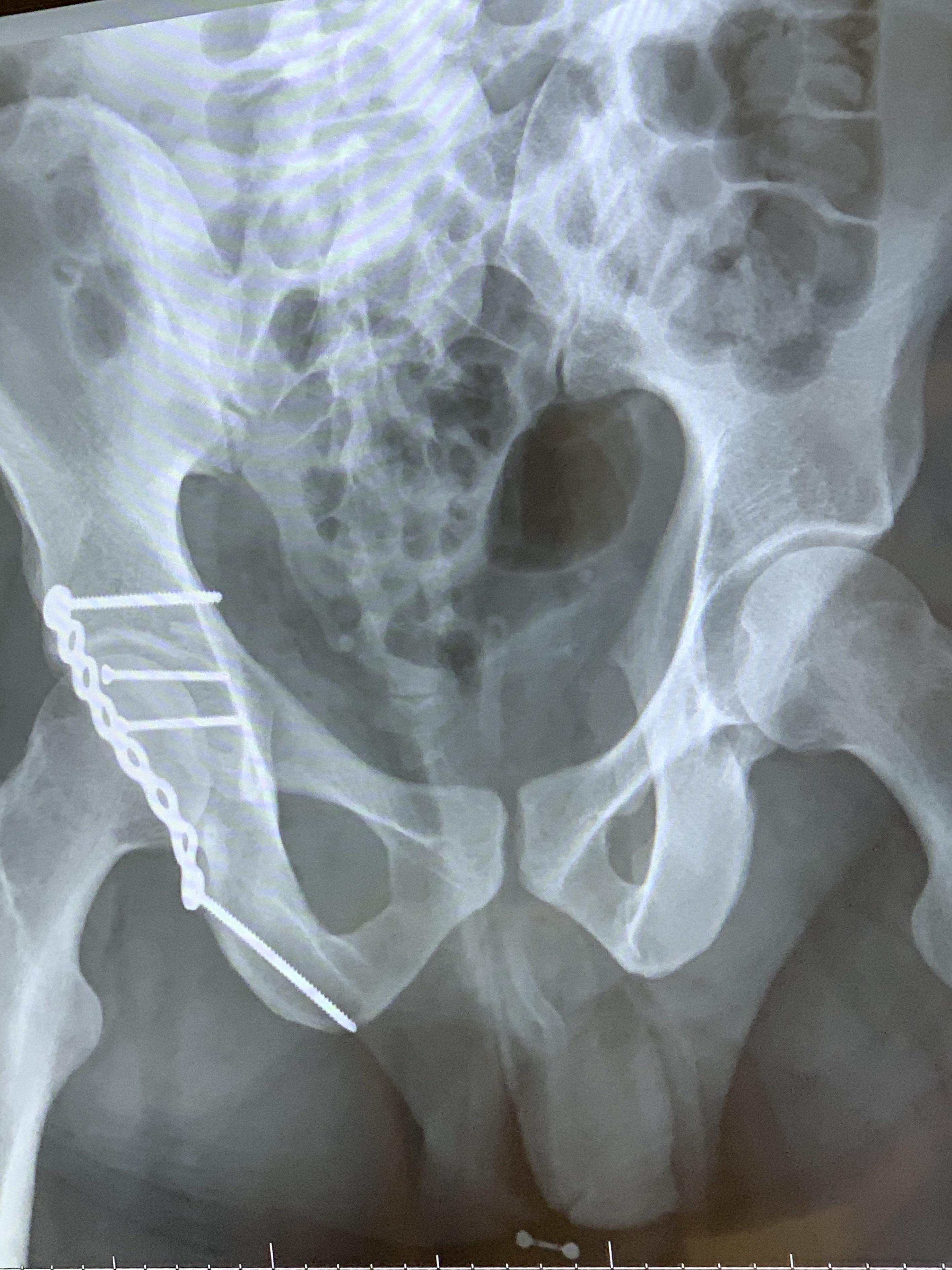 X ray of my hip and piercing. | Scrolller