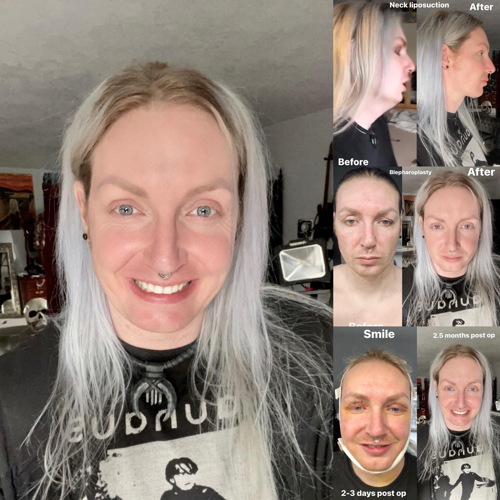 2.5 months post op Blepharoplasty and neck liposuction | Scrolller