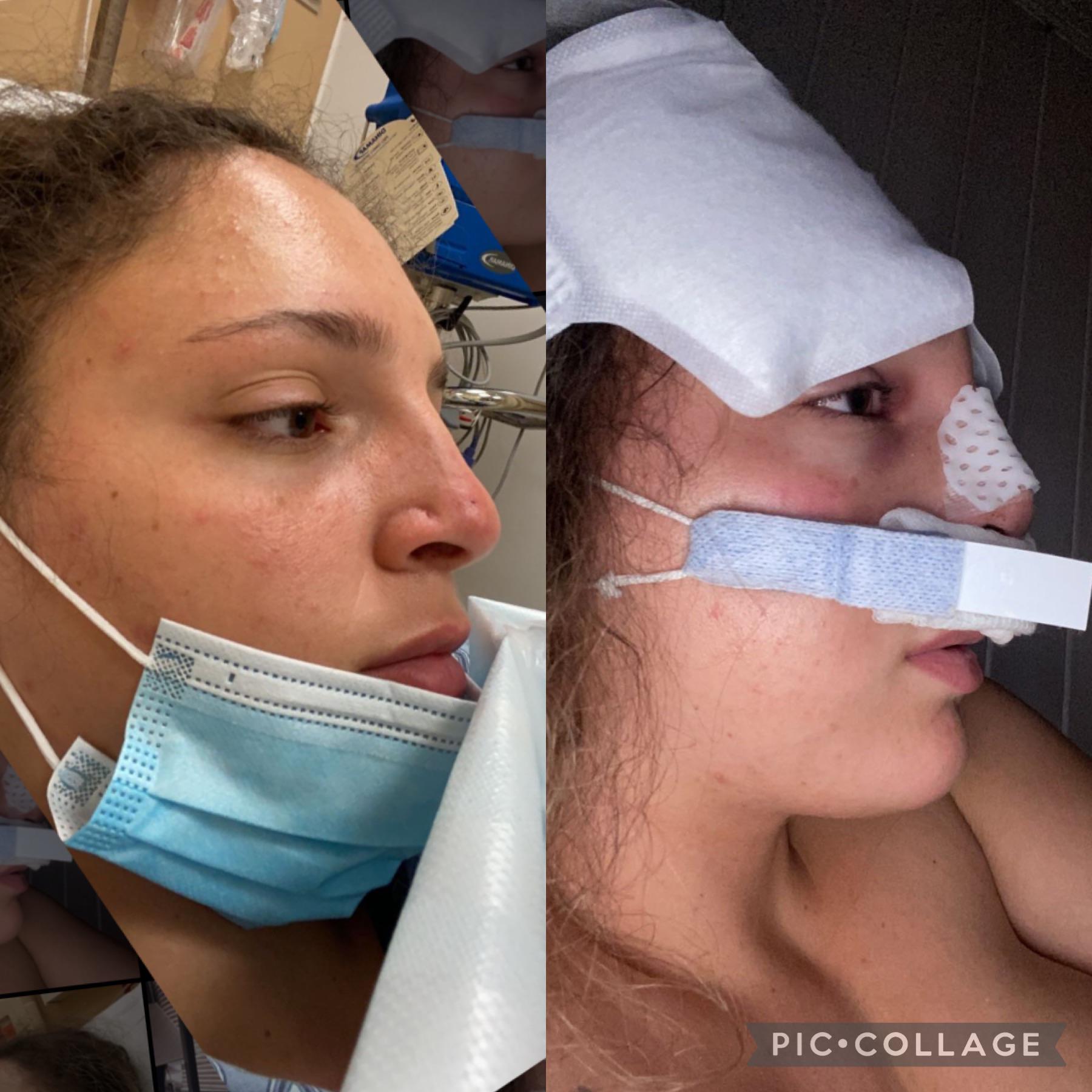 2 days post op! | Scrolller