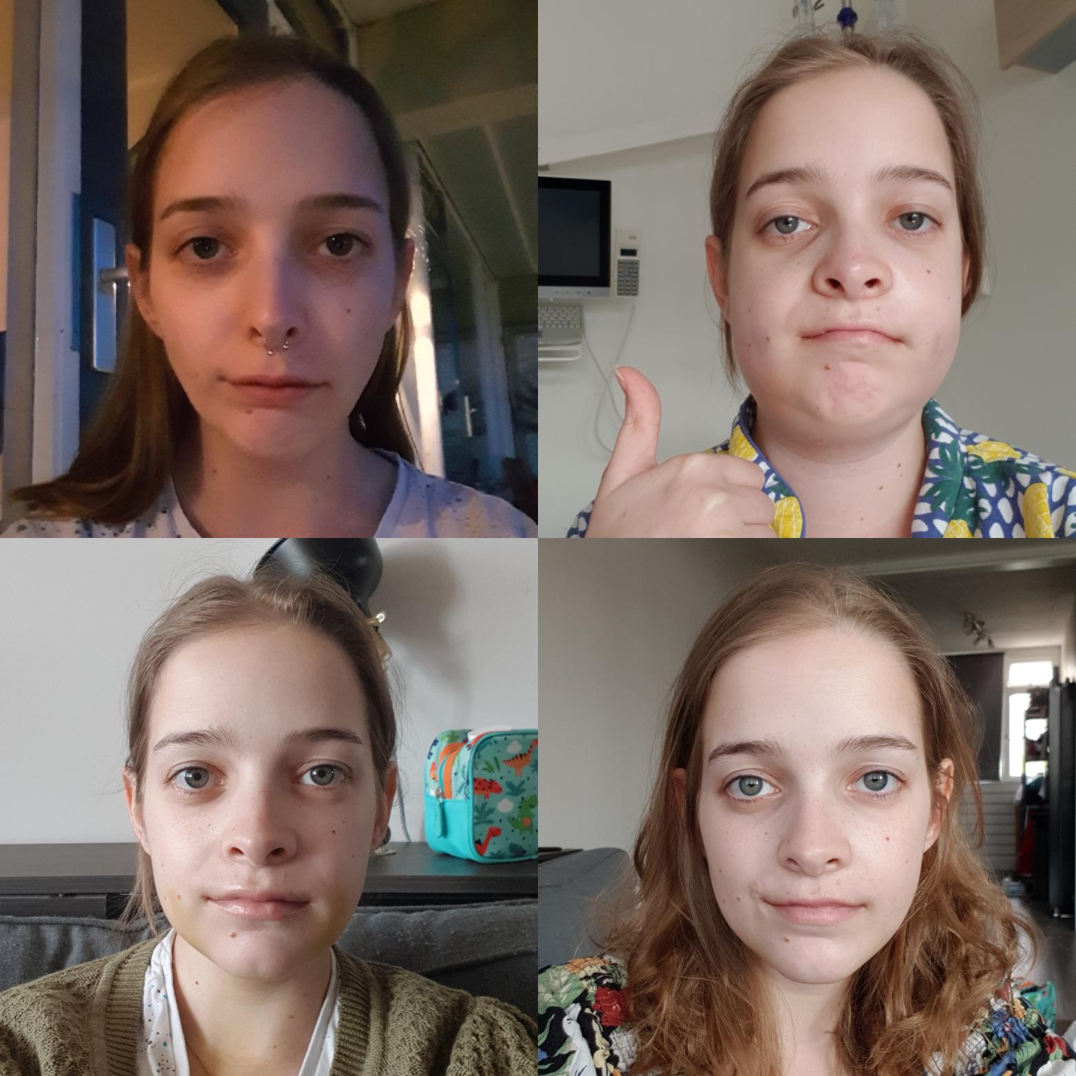2 week post-op DJS!!! Before VS 2 days post-op VS 1 week post-op VS 2 weeks post-op | Scrolller