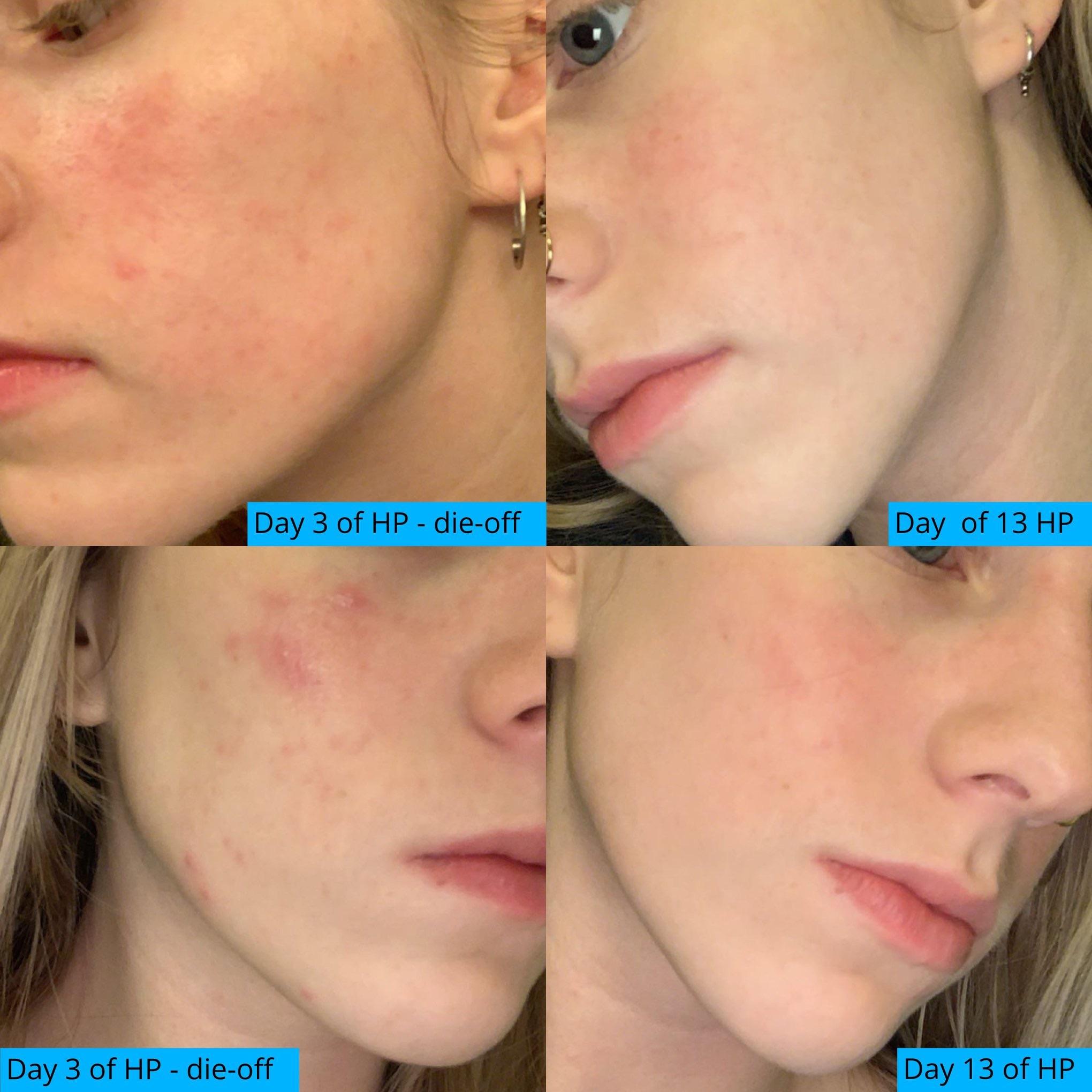 2 weeks using horse paste | Scrolller