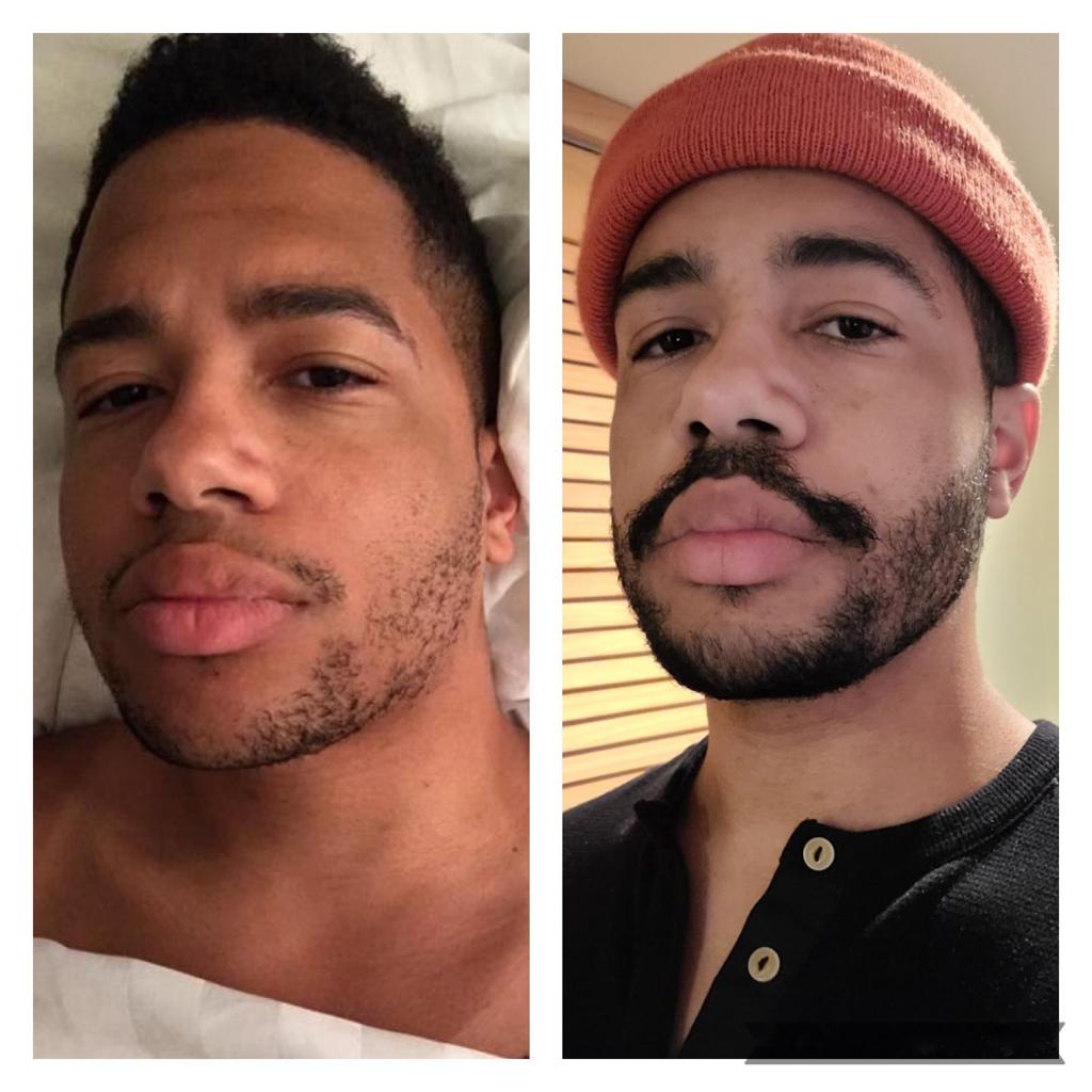 Discover more like Minoxbeards: 4 month progress and Related Content | Scrolller