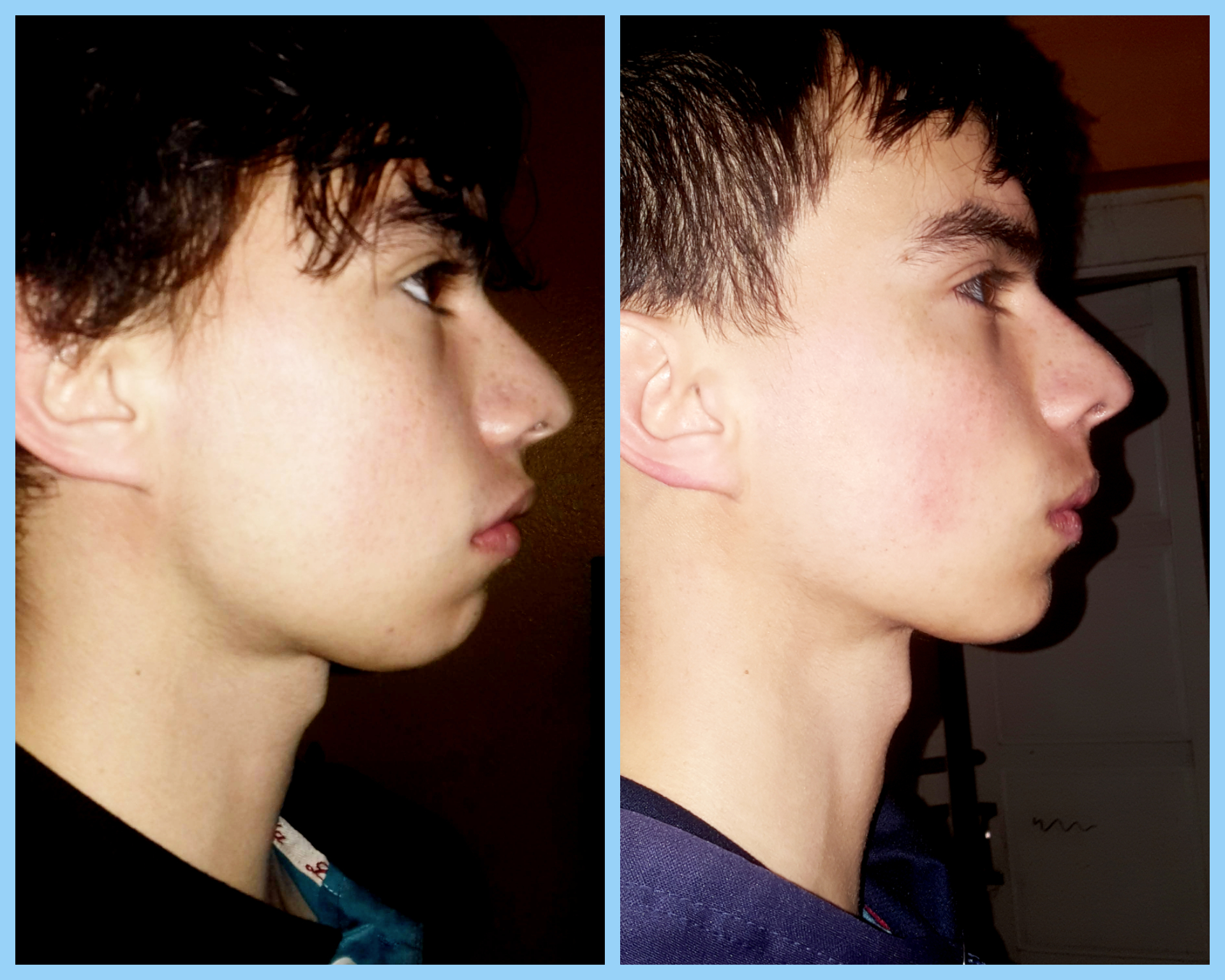 6 Month Mewing transformation (18M) | Scrolller 6 Month Mewing transformation (18M) | Scrolller