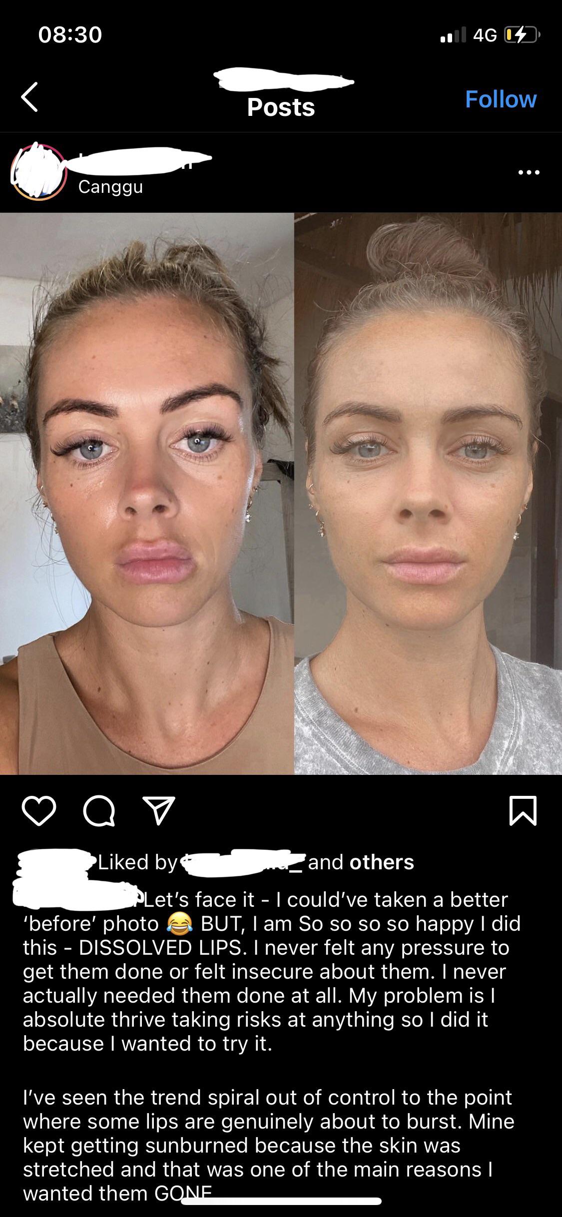A great example of dissolving lip fillers | Scrolller