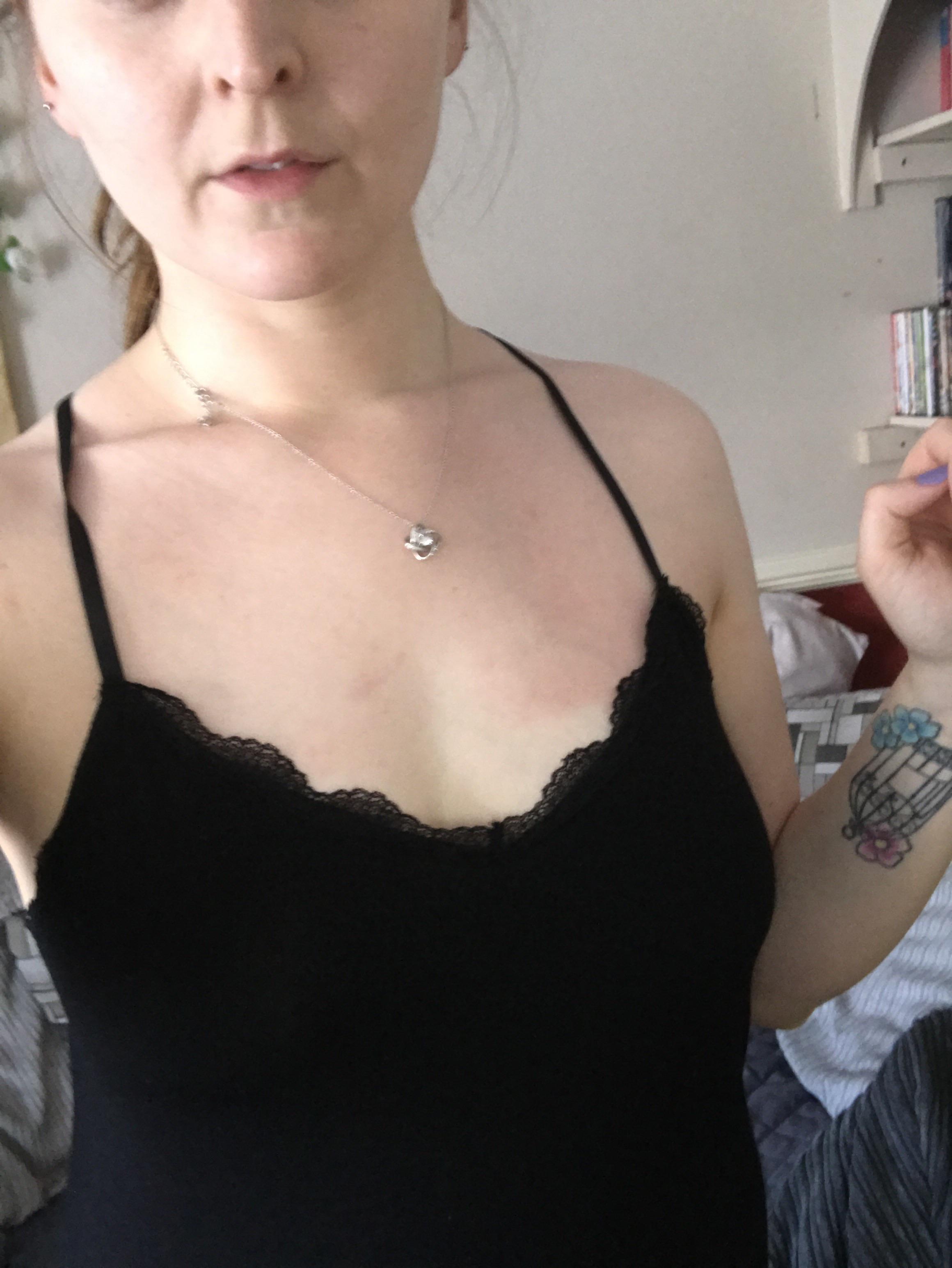 Abit of Sun burn | Scrolller