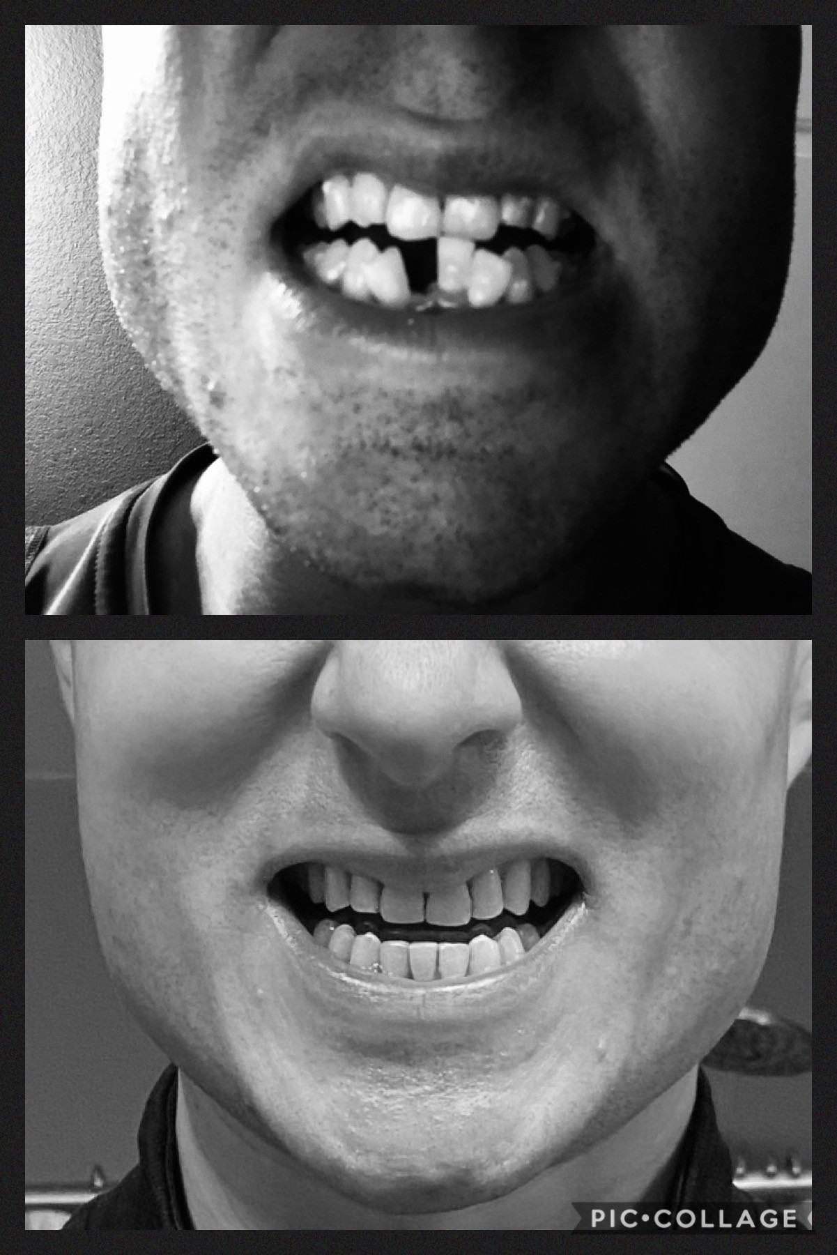 After a tooth extraction, 52 trays, and 14 refinements- Mission Complete. | Scrolller