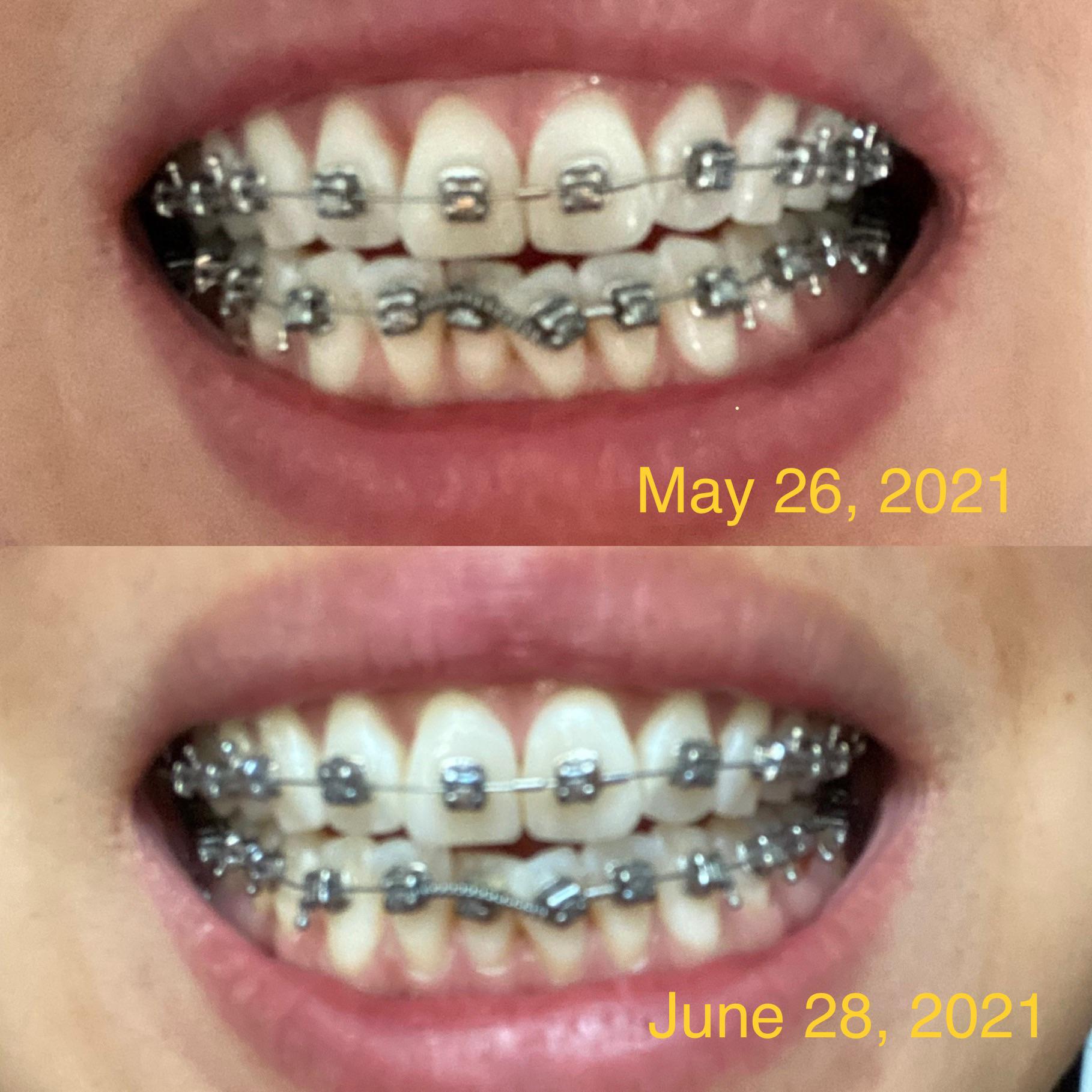 Almost 5 week progress pic. Top photo is day 1. Can’t see much progress ...