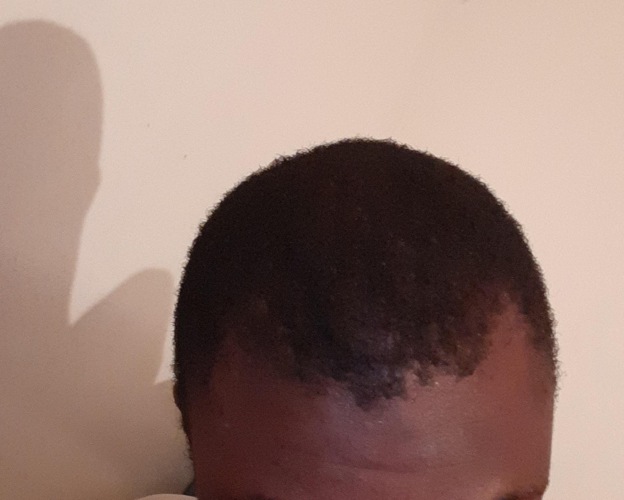 Am a balding? And if so should I just shave it off or try getting a line up | Scrolller
