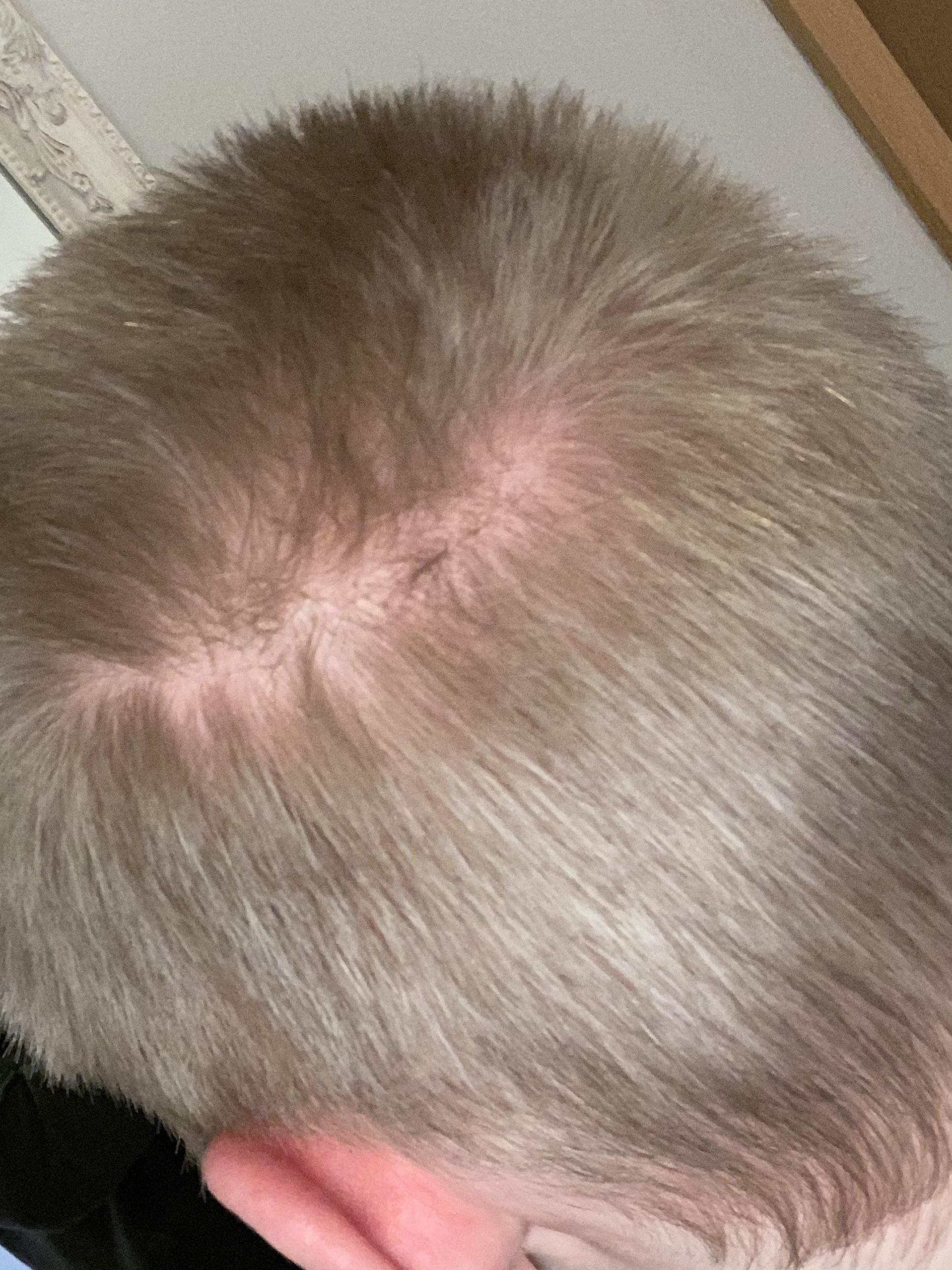 Am I Going Bald at 15 Years Old? | Scrolller