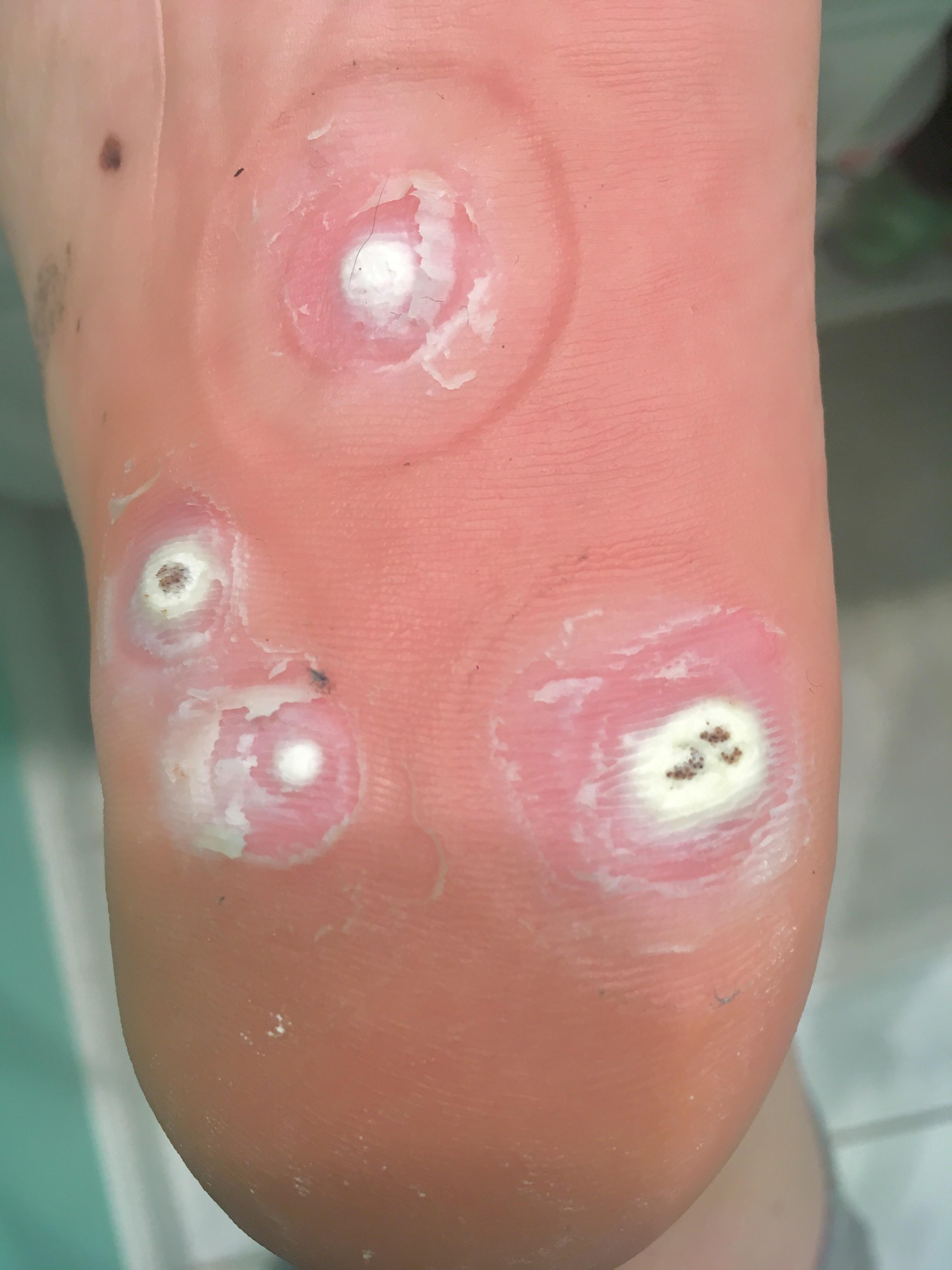 Another horrifying wart update | Scrolller